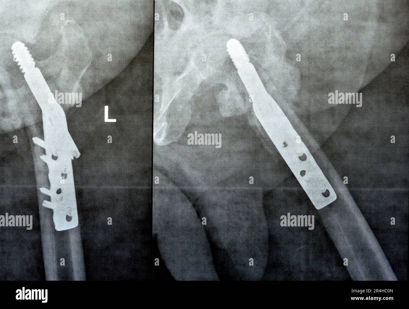 Col cervical trans de la hanche gauche de la fracture du fémur fixé par ...