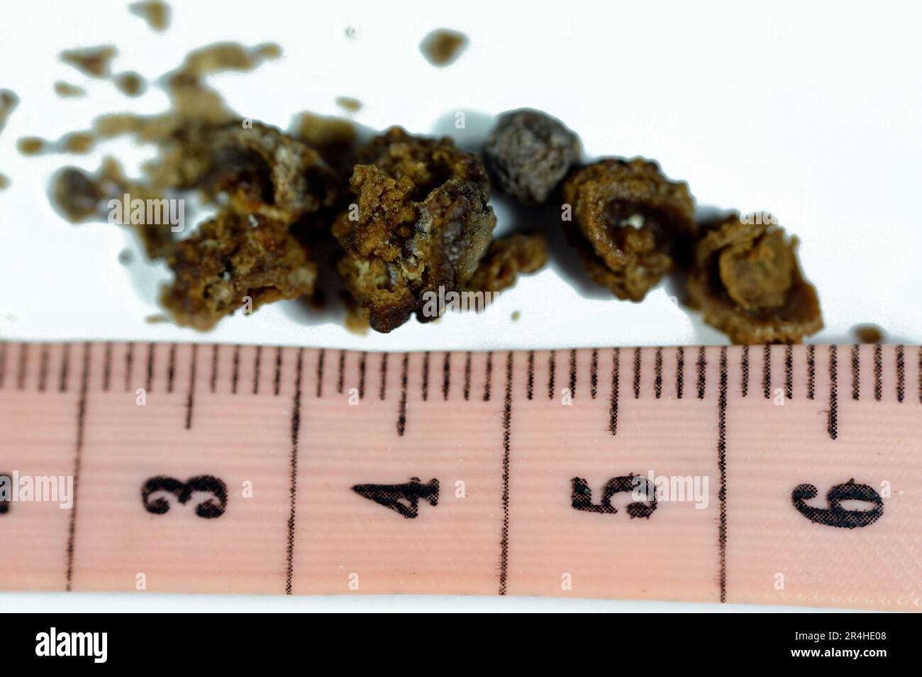 Calcul des voies urinaires Banque de photographies et d’images à haute ...