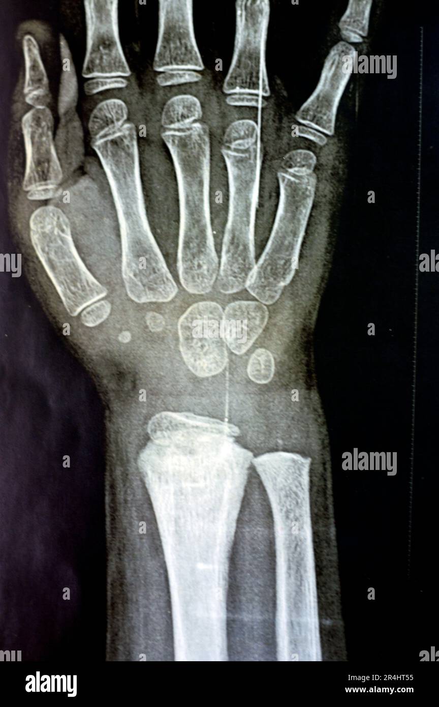 Squelette bras droit Banque de photographies et d’images à haute ...