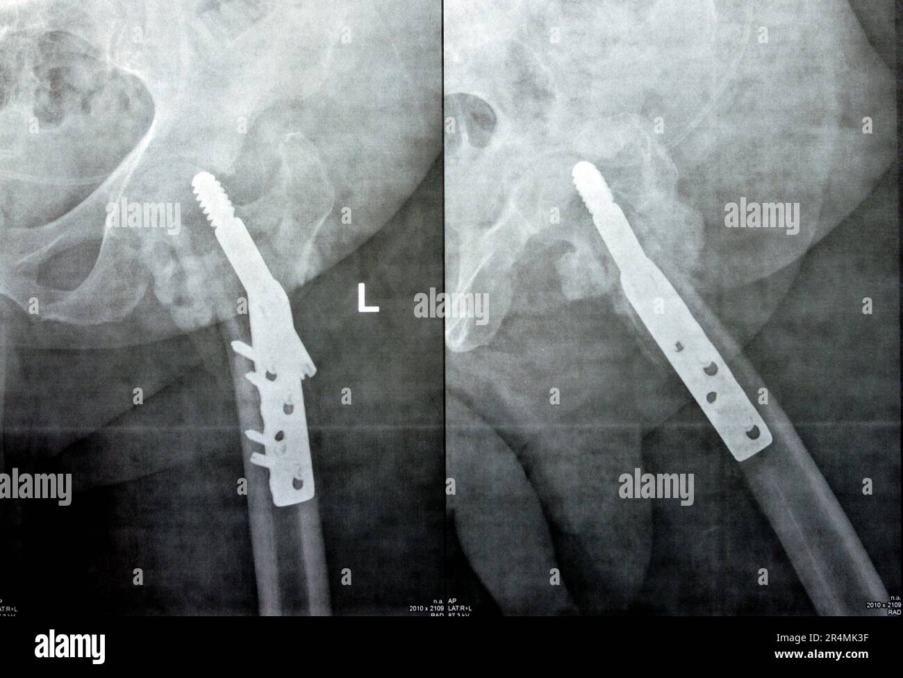 Col cervical trans de la hanche gauche de la fracture du fémur fixé par ...