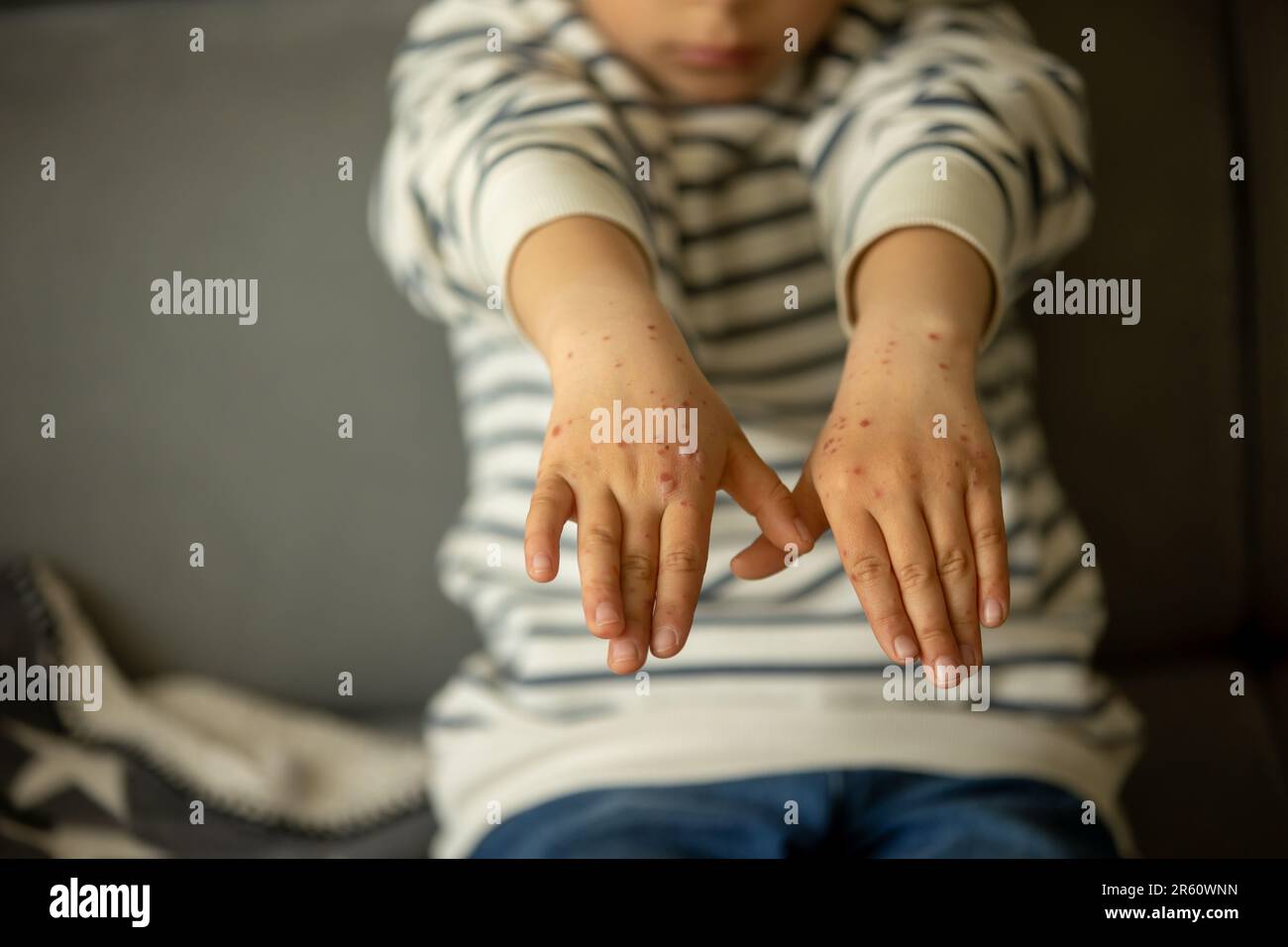 Enfant avec une éruption cutanée, roséola, maladie main-pied-et-bouche ...
