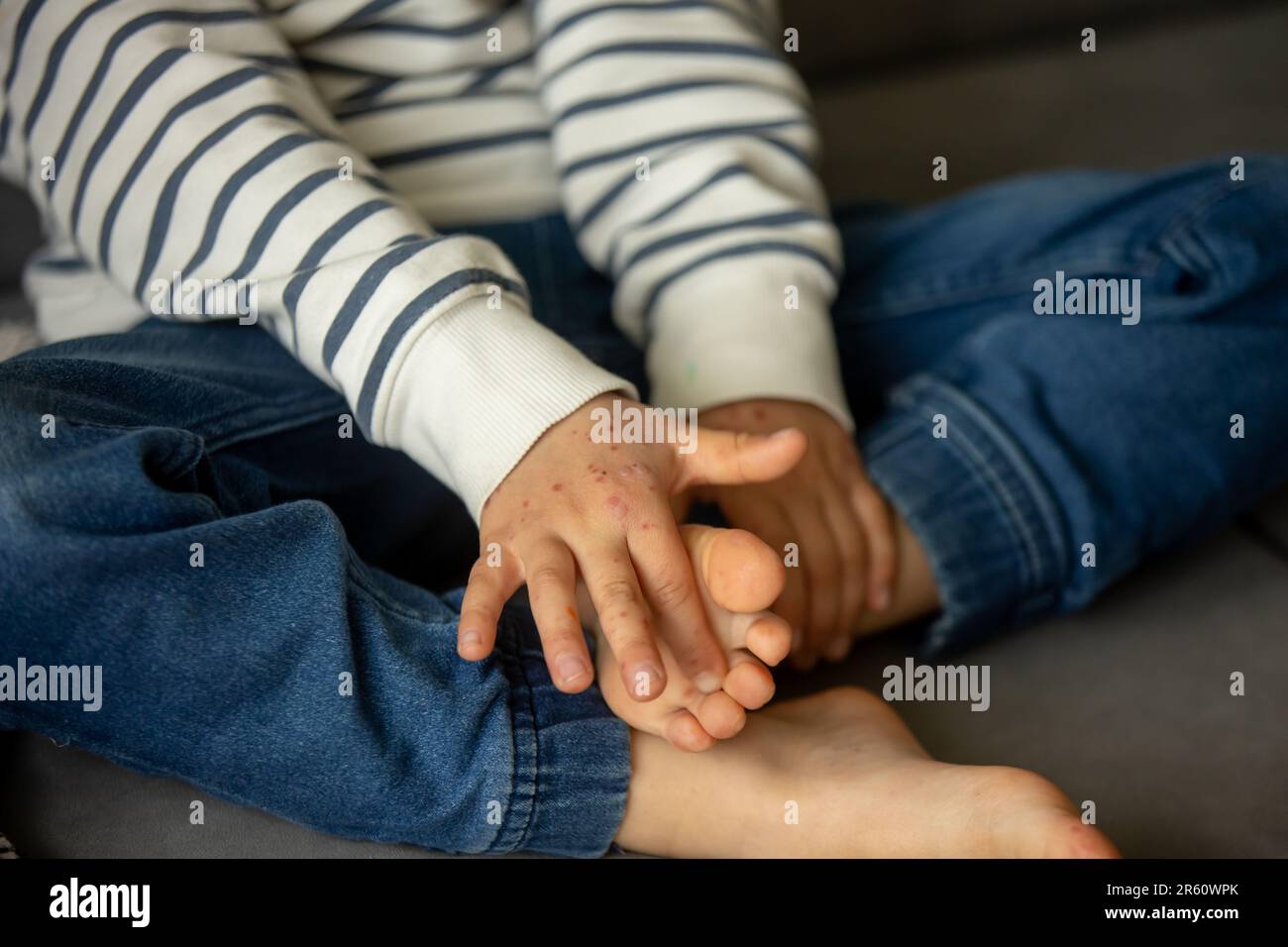 Enfant avec une éruption cutanée, roséola, maladie main-pied-et-bouche ...
