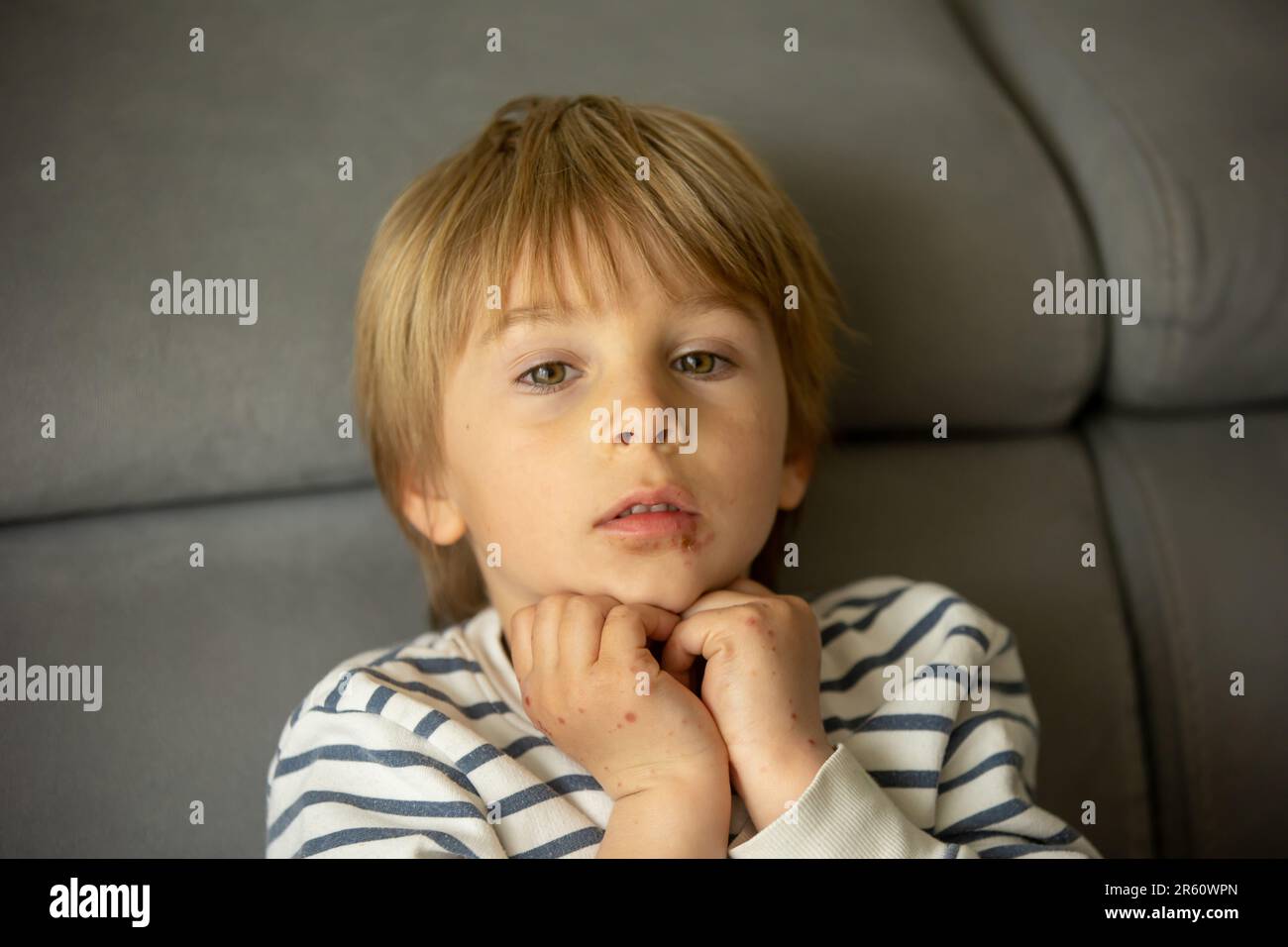 Enfant avec une éruption cutanée, roséola, maladie main-pied-et-bouche ...