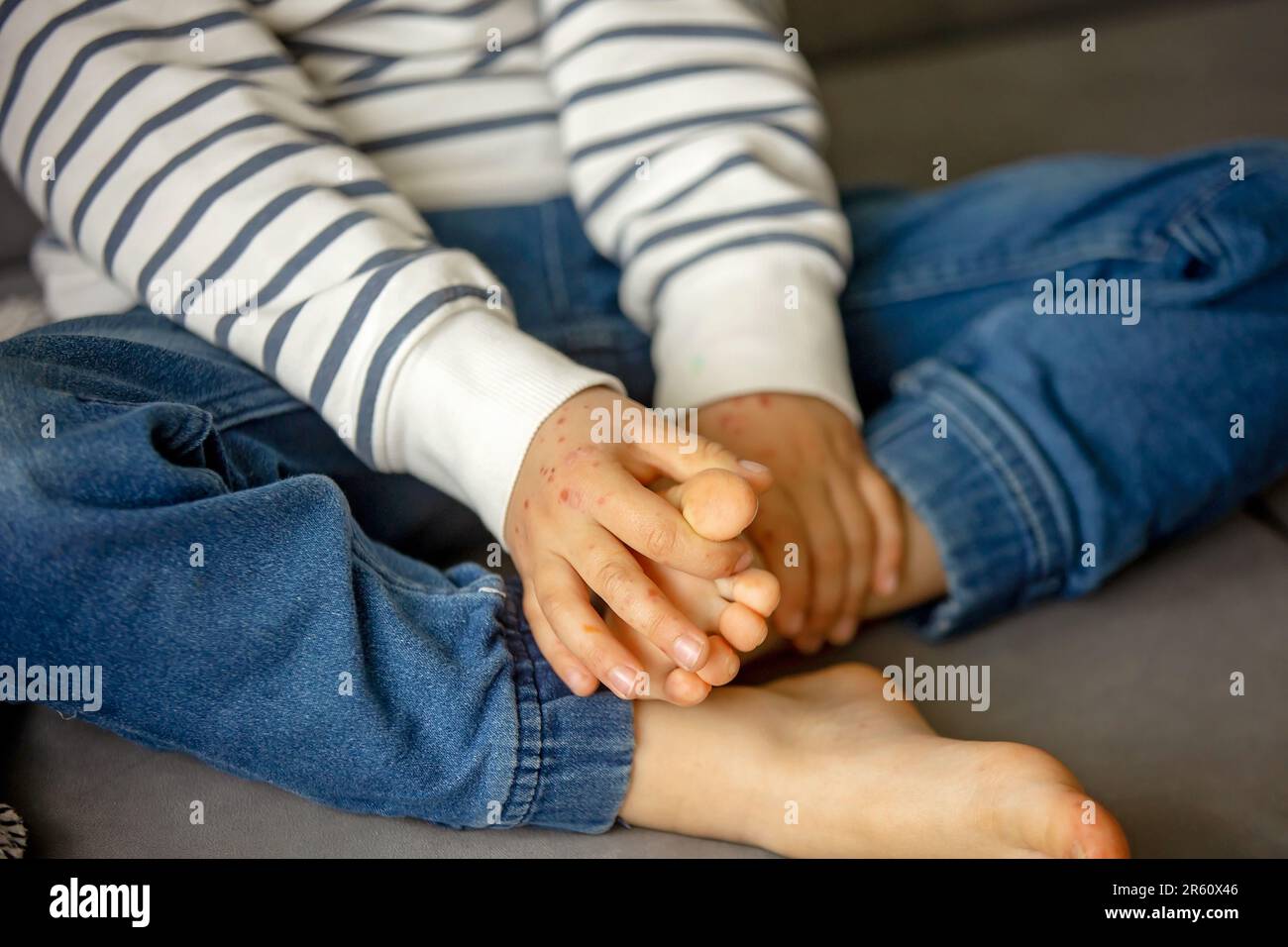 Enfant avec une éruption cutanée, roséola, maladie main-pied-et-bouche ...