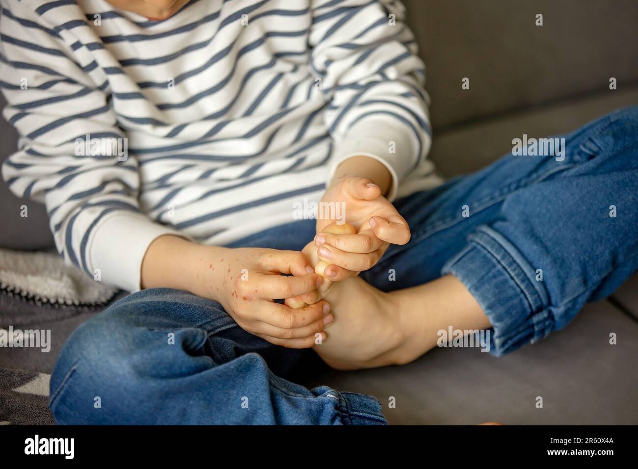 Enfant avec une éruption cutanée, roséola, maladie main-pied-et-bouche ...