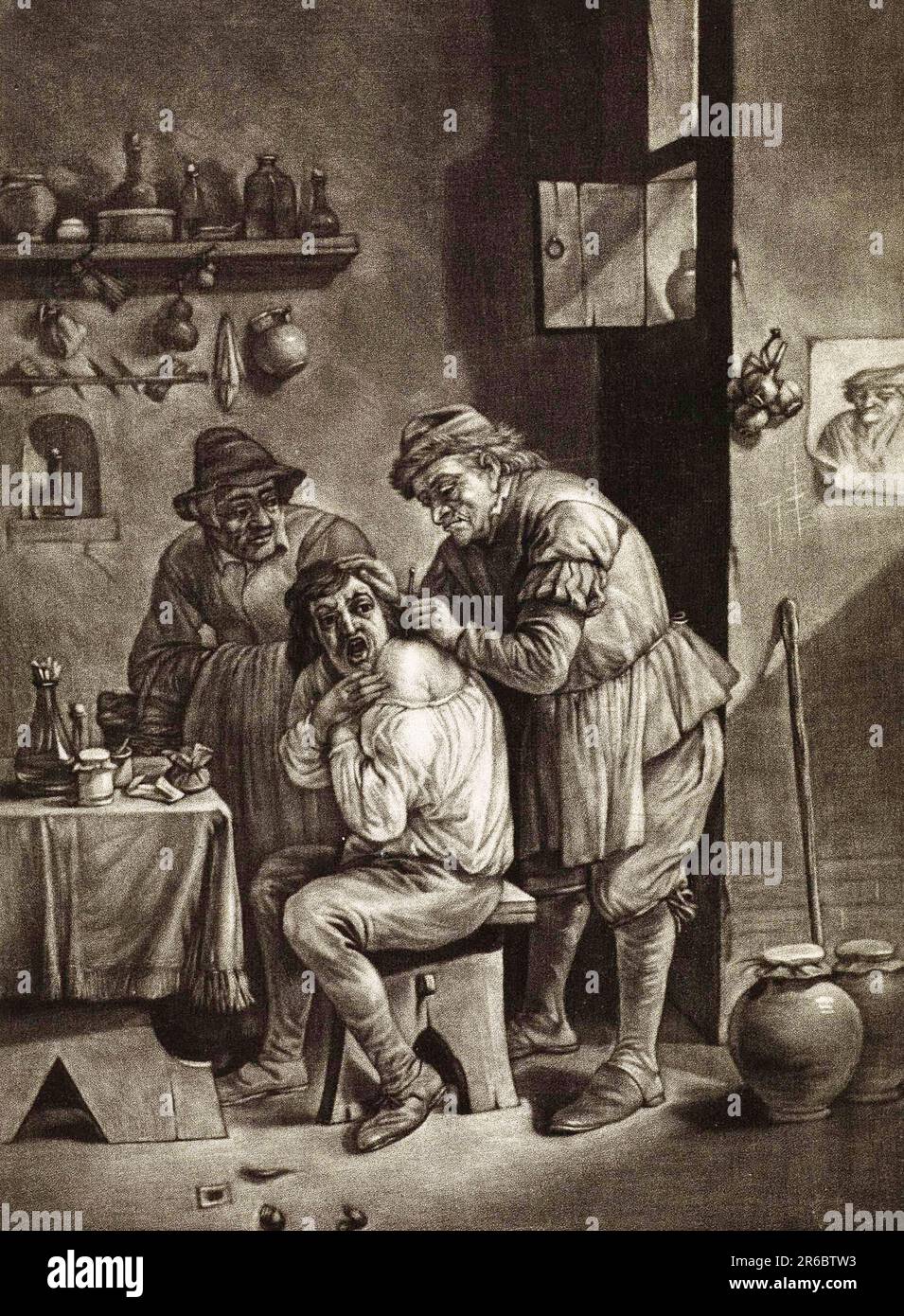 Médecine, anatomie, chirurgie, chirurgie de l'épaule, vers 1700 ...