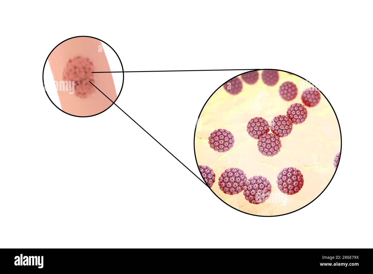 Verrues péniennes (génitales) et vue rapprochée du virus du papillome ...