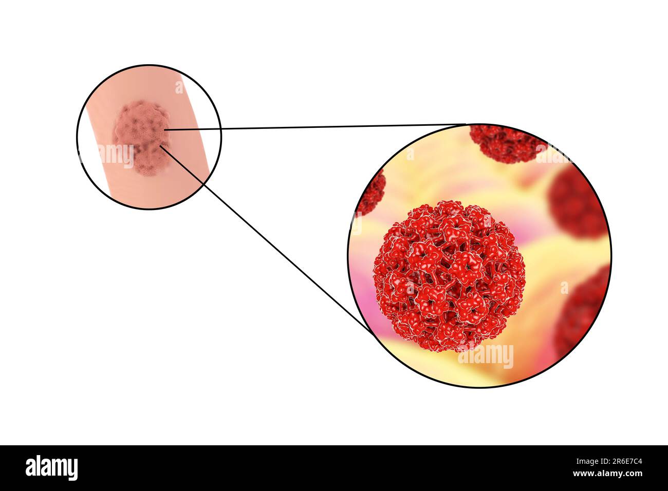 Verrues péniennes (génitales) et vue rapprochée du virus du papillome ...