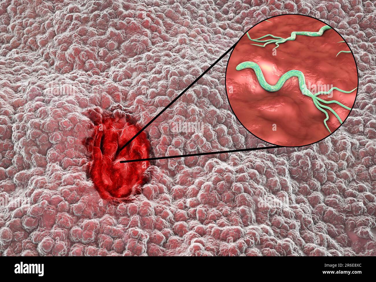Ulcère gastrique (estomac) et vue rapprochée de la bactérie ...