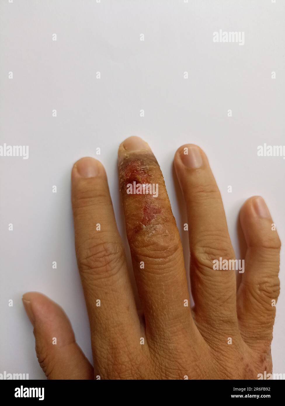 dermatite d'eczéma éruption cutanée sur la main. inflammation de la ...