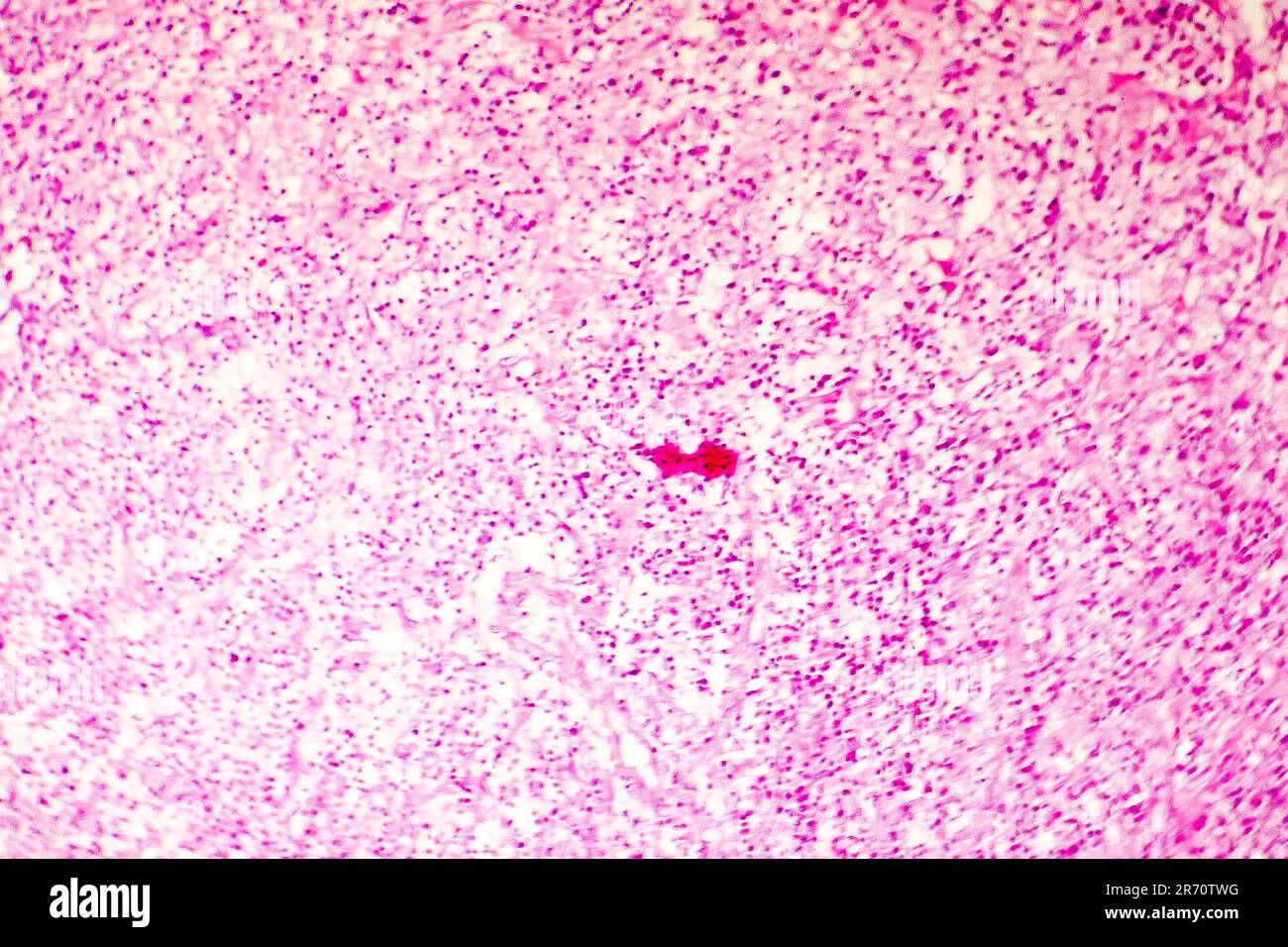Nécrose liquefactive du cerveau humain, photomicrographe lumineux ...