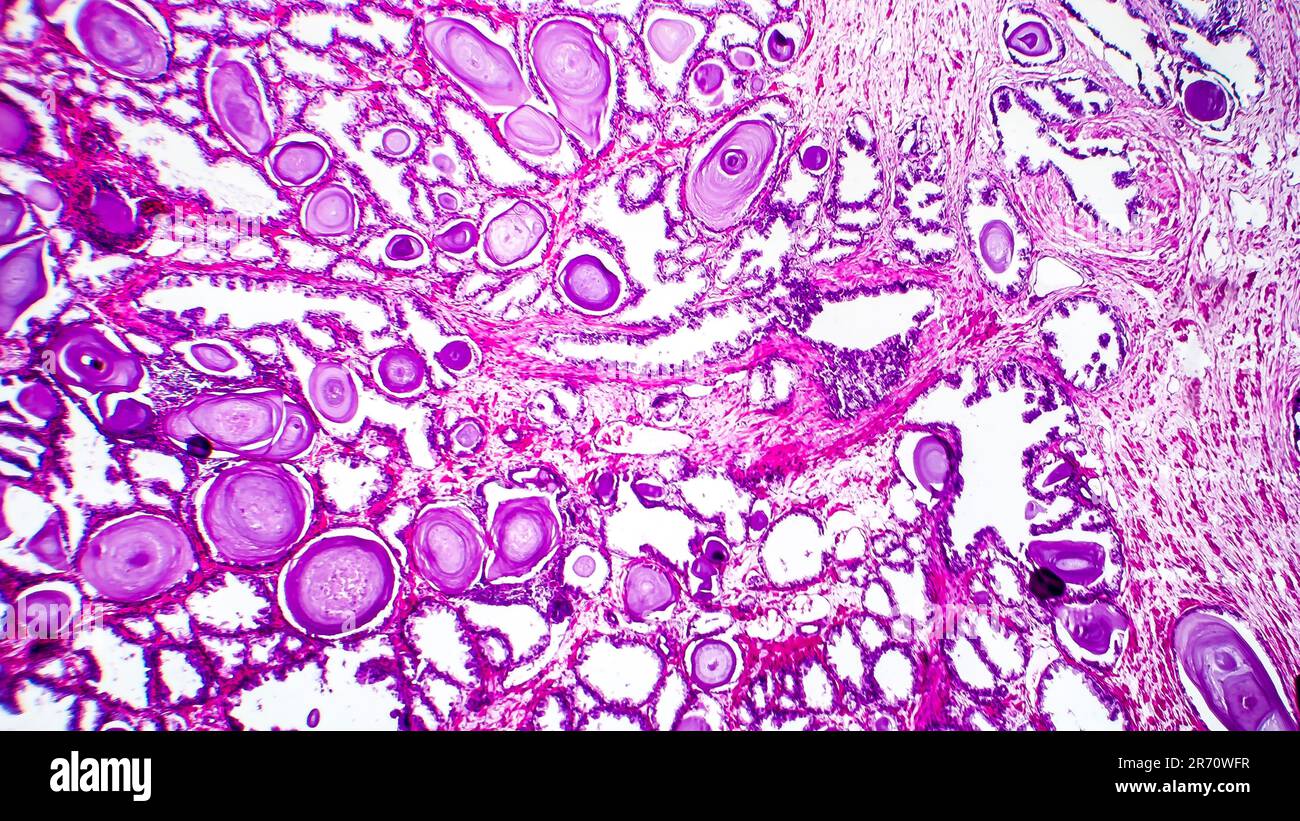 Glándula prostática histología Banque de photographies et d’images à ...