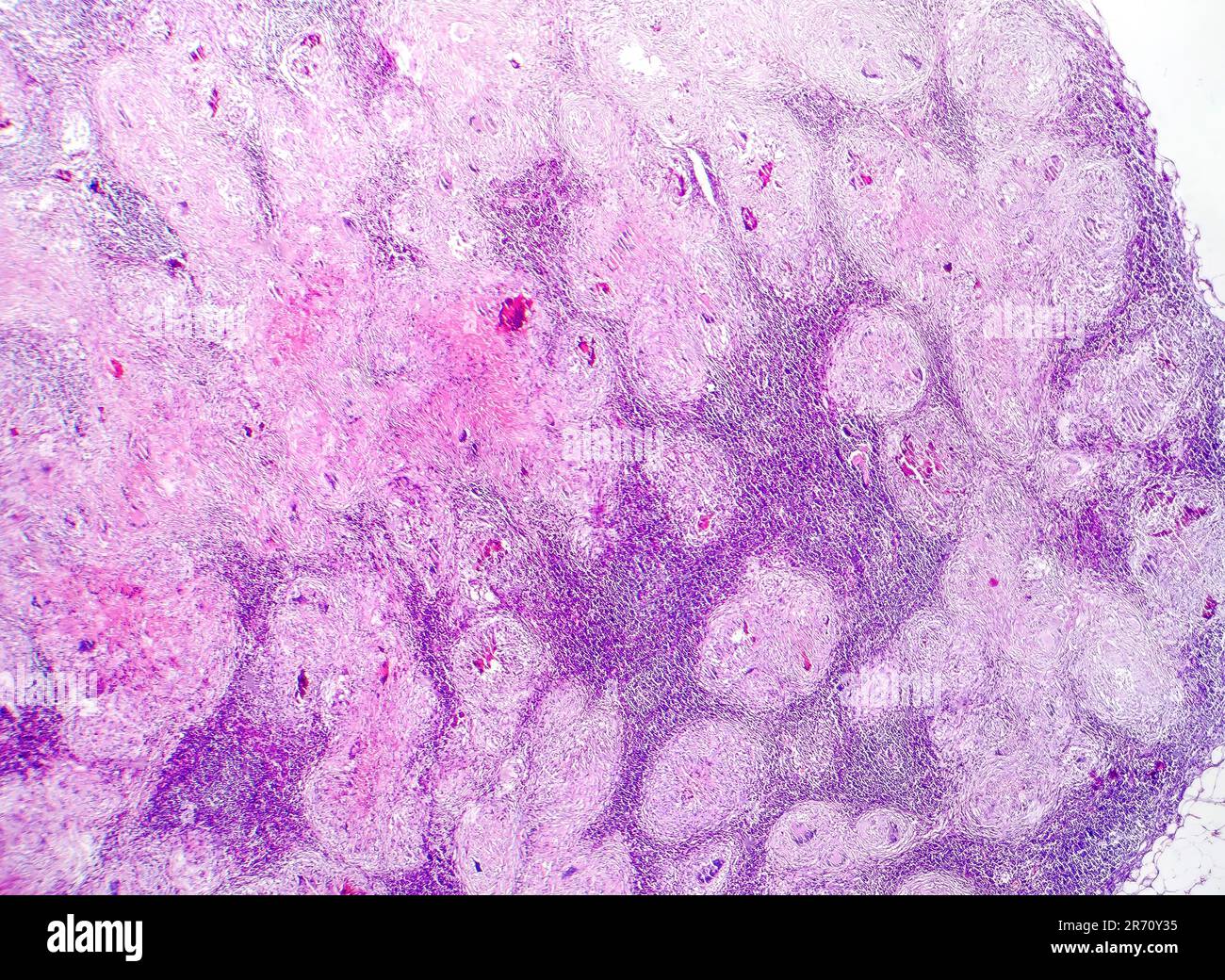 Nécrose caséeuse du nœud lymphatique, micrographe léger, photo sous ...