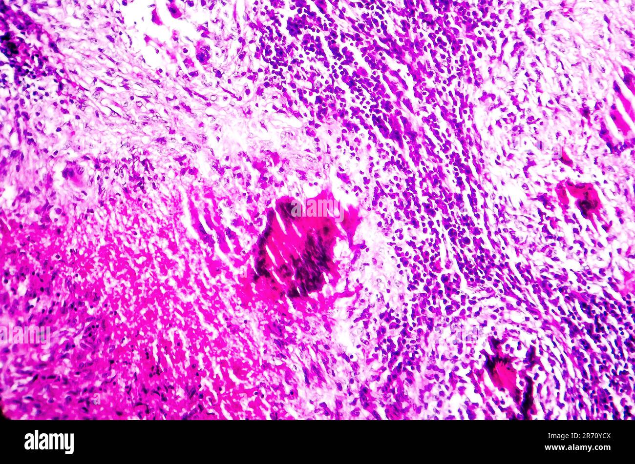 Nécrose caséeuse du nœud lymphatique, micrographe léger, photo sous ...