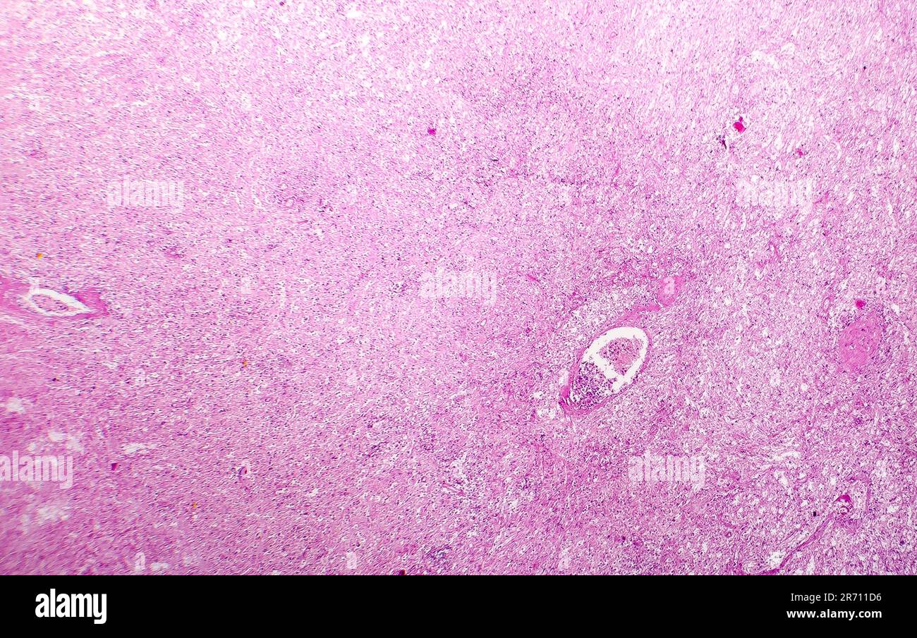 Micro infarctus Banque de photographies et d’images à haute résolution ...