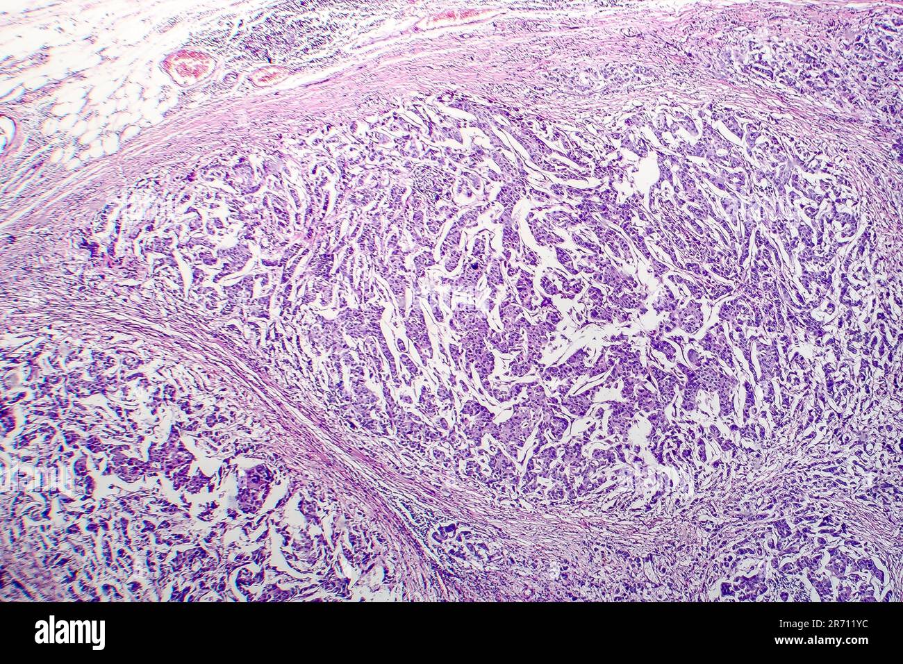 Cancer du ganglion lymphatique, micrographe léger, photo au microscope ...
