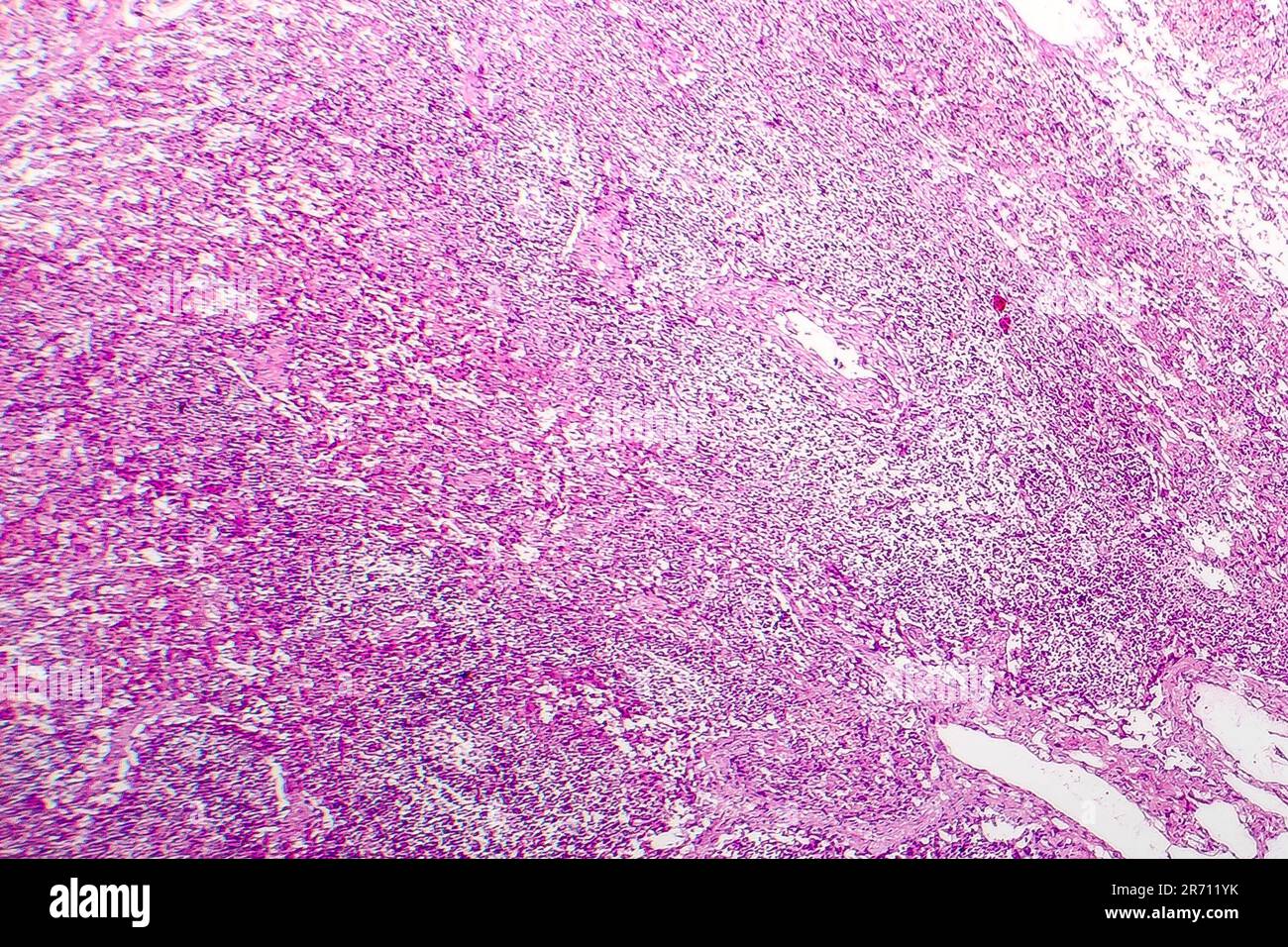 Lymphadénitites hémorragiques, inflammation et hémorragie des ganglions ...