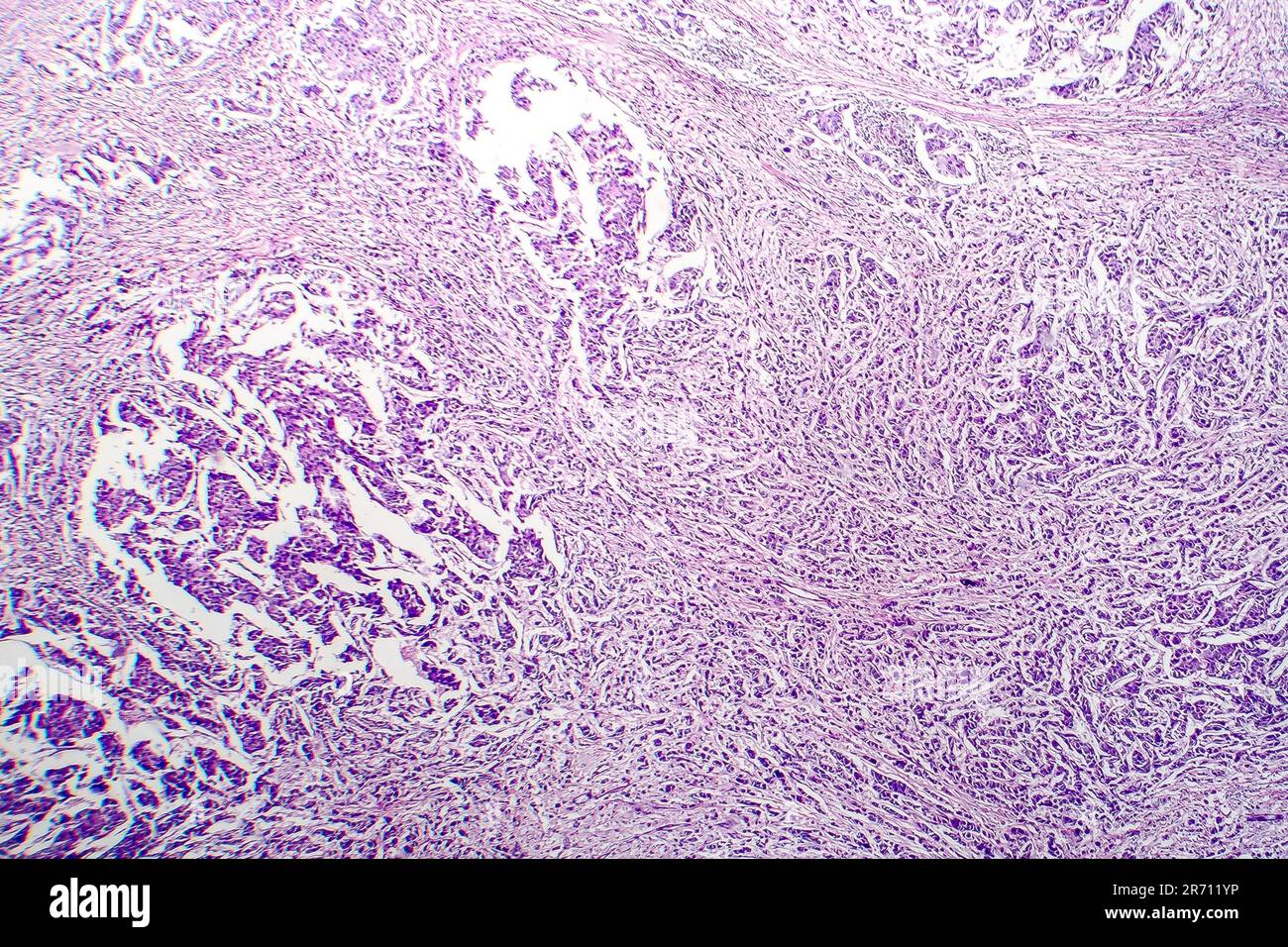 Cancer du ganglion lymphatique, micrographe léger, photo au microscope ...
