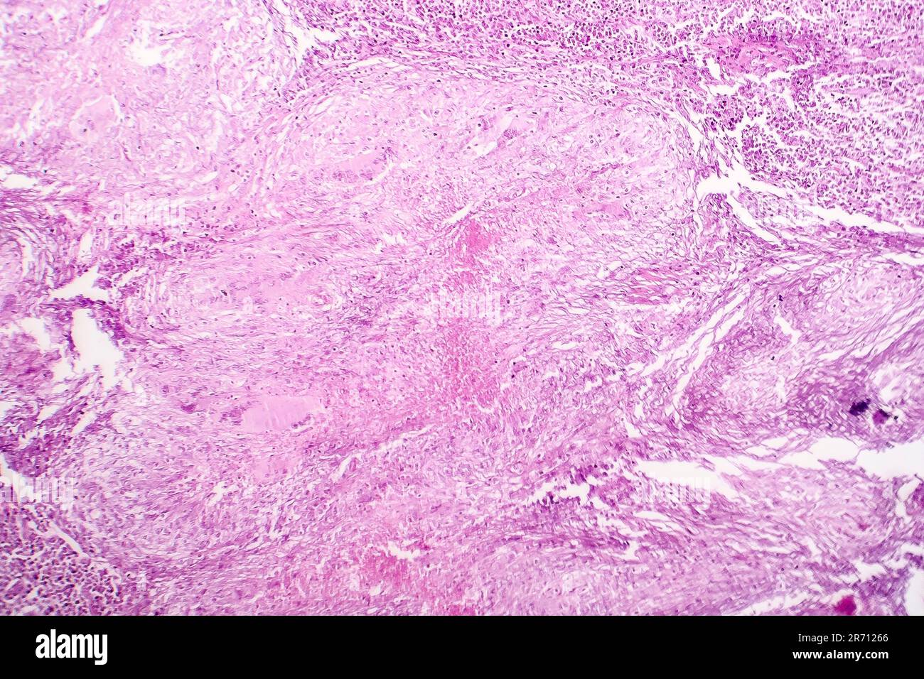 Histopathologie de la tuberculose ganglionnaire lymphatique ...