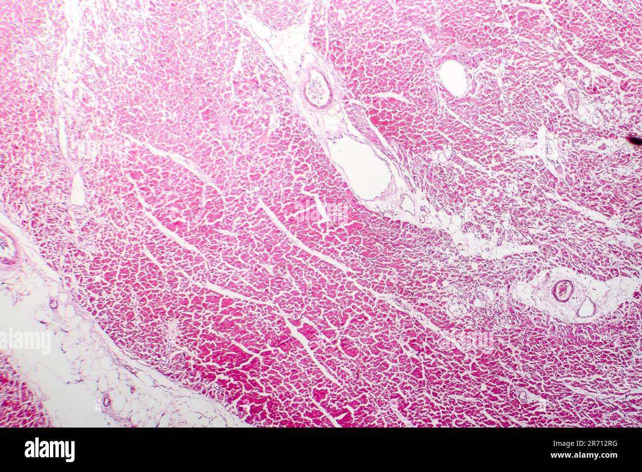 Histopathologie de la myocardite bactérienne, maladie cardiaque ...