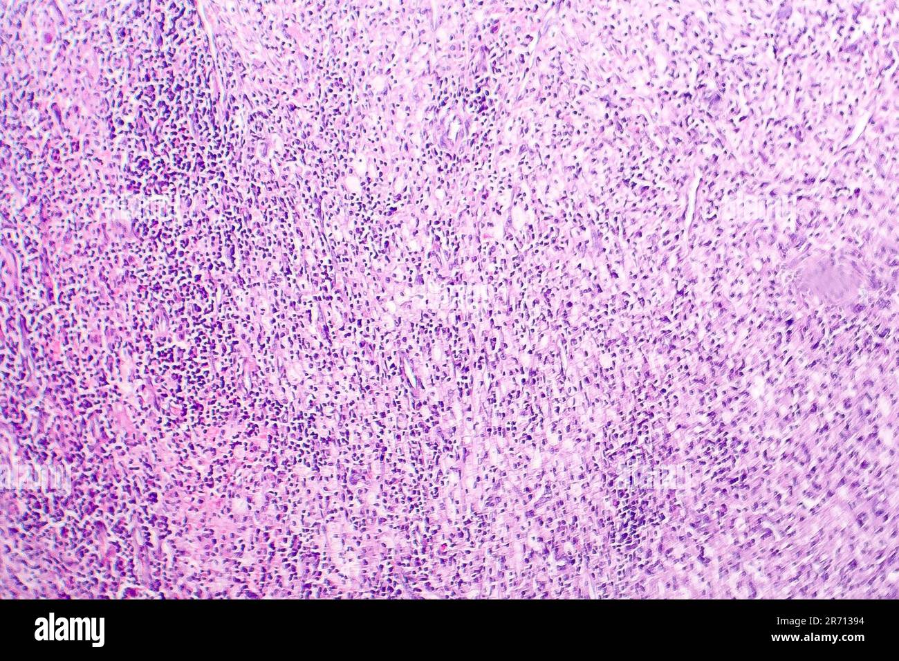 Histopathologie de la cholécystite chronique, micrographe léger ...