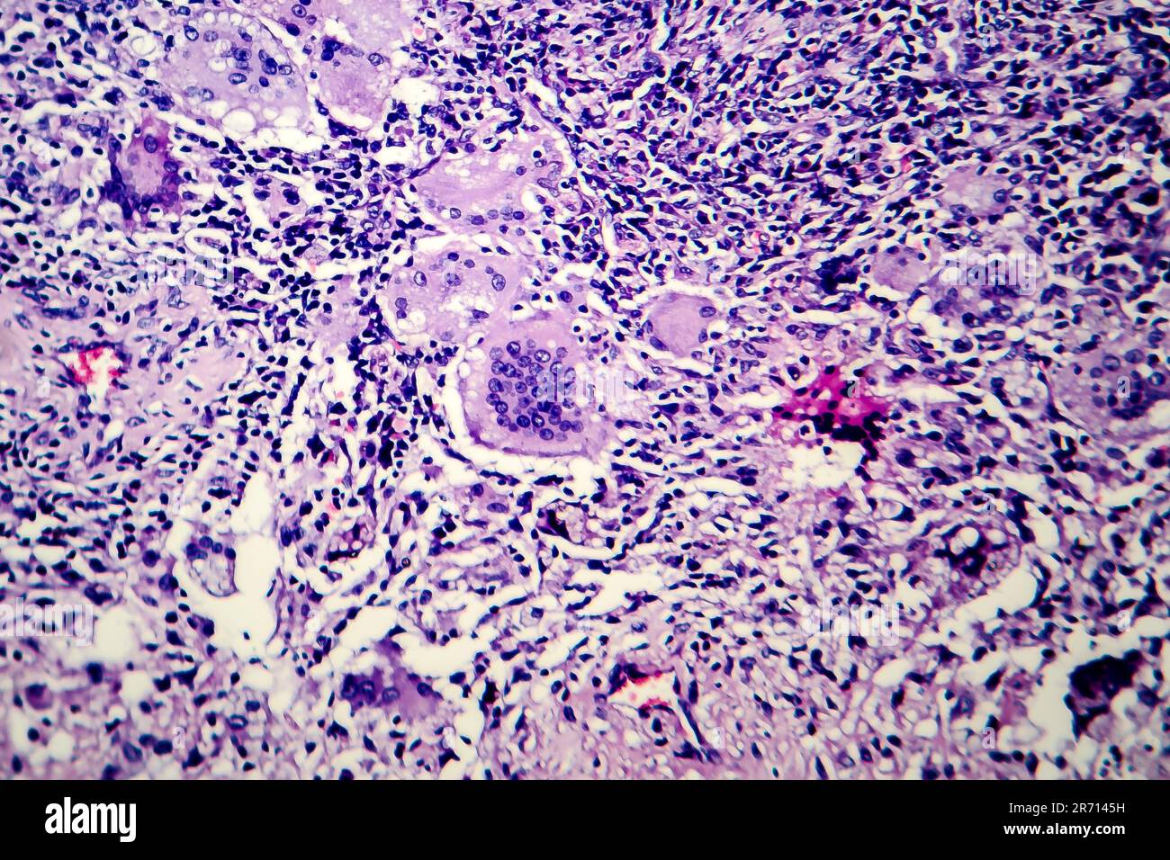 Histopathologie de la tuberculose, micrographe léger de la lésion de la ...