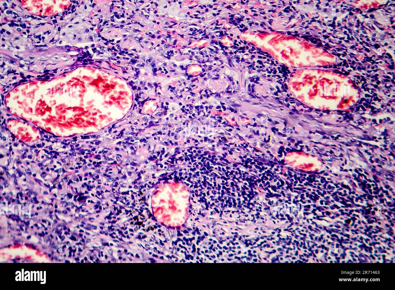 Histopathologie de la tuberculose, micrographe léger de la lésion de la ...