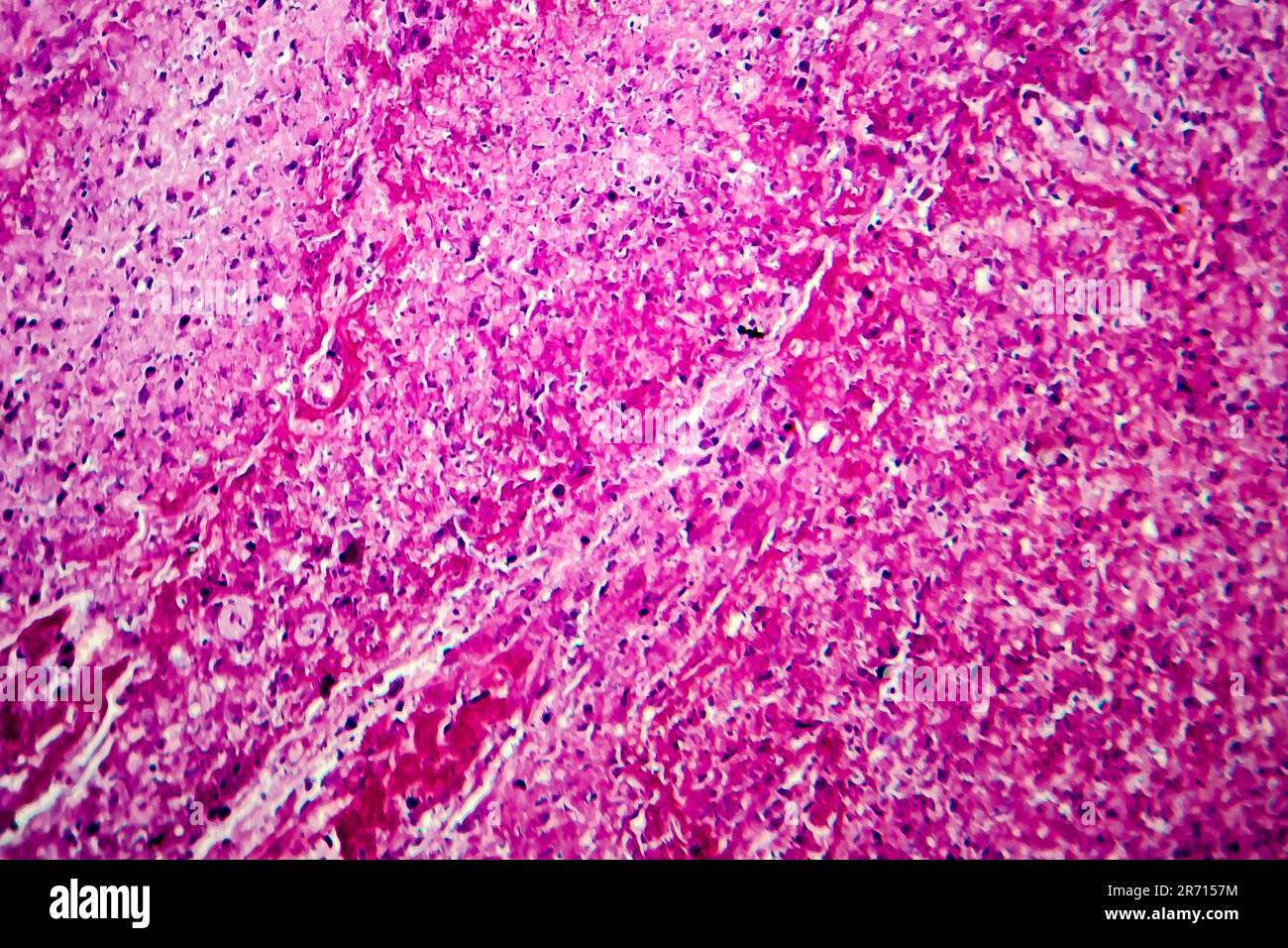 Caséation du granulome de la tuberculose humaine, micrographe léger ...