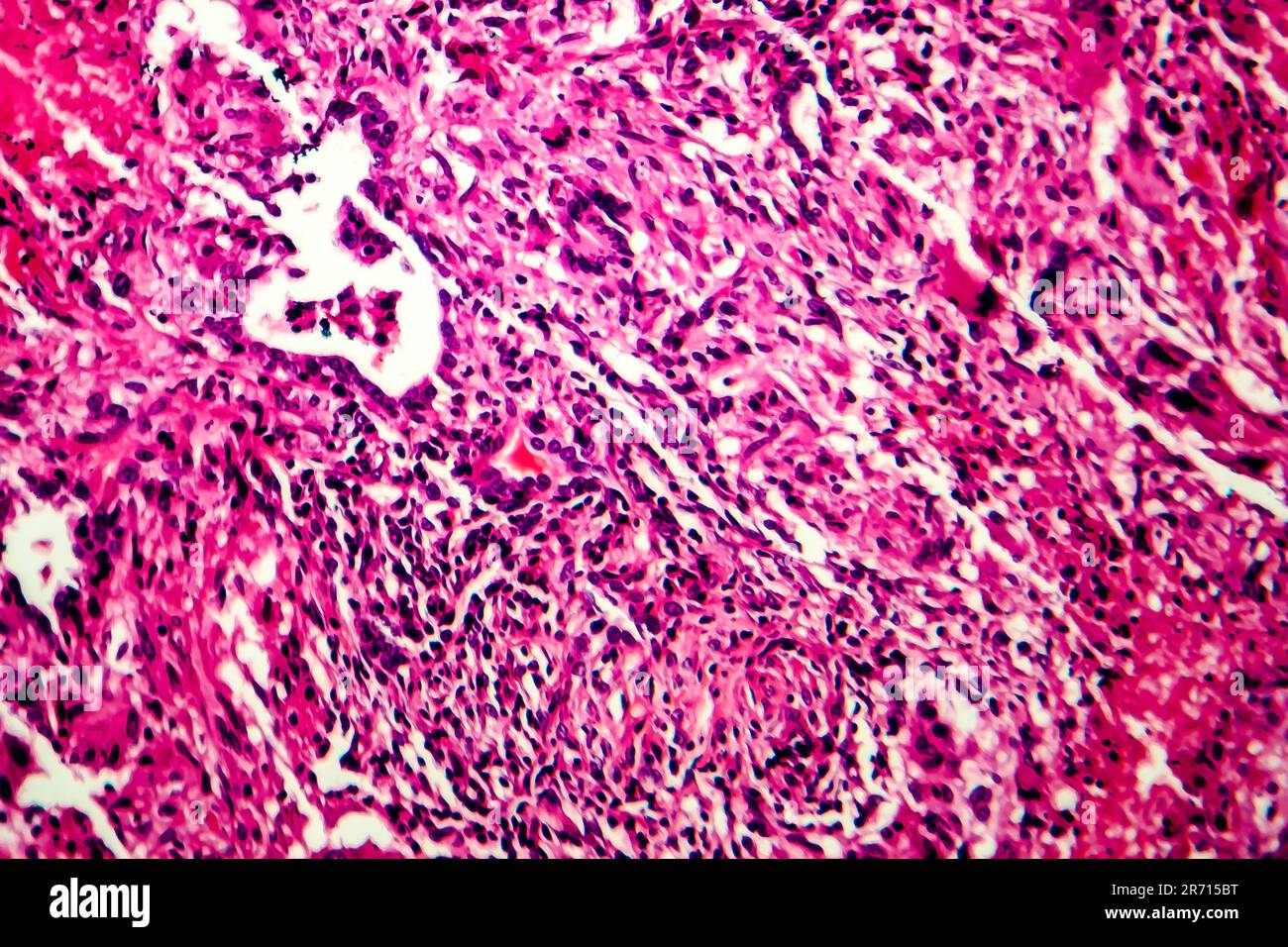 Tuberculose miliaire, micrographe léger, photo au microscope Photo ...