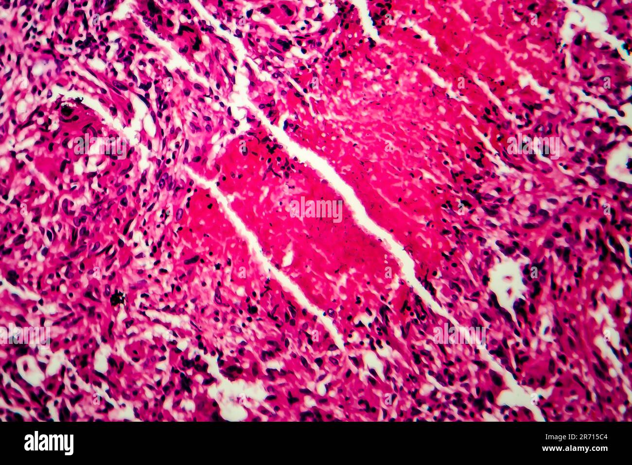 Tuberculose miliaire, micrographe léger, photo au microscope Photo ...
