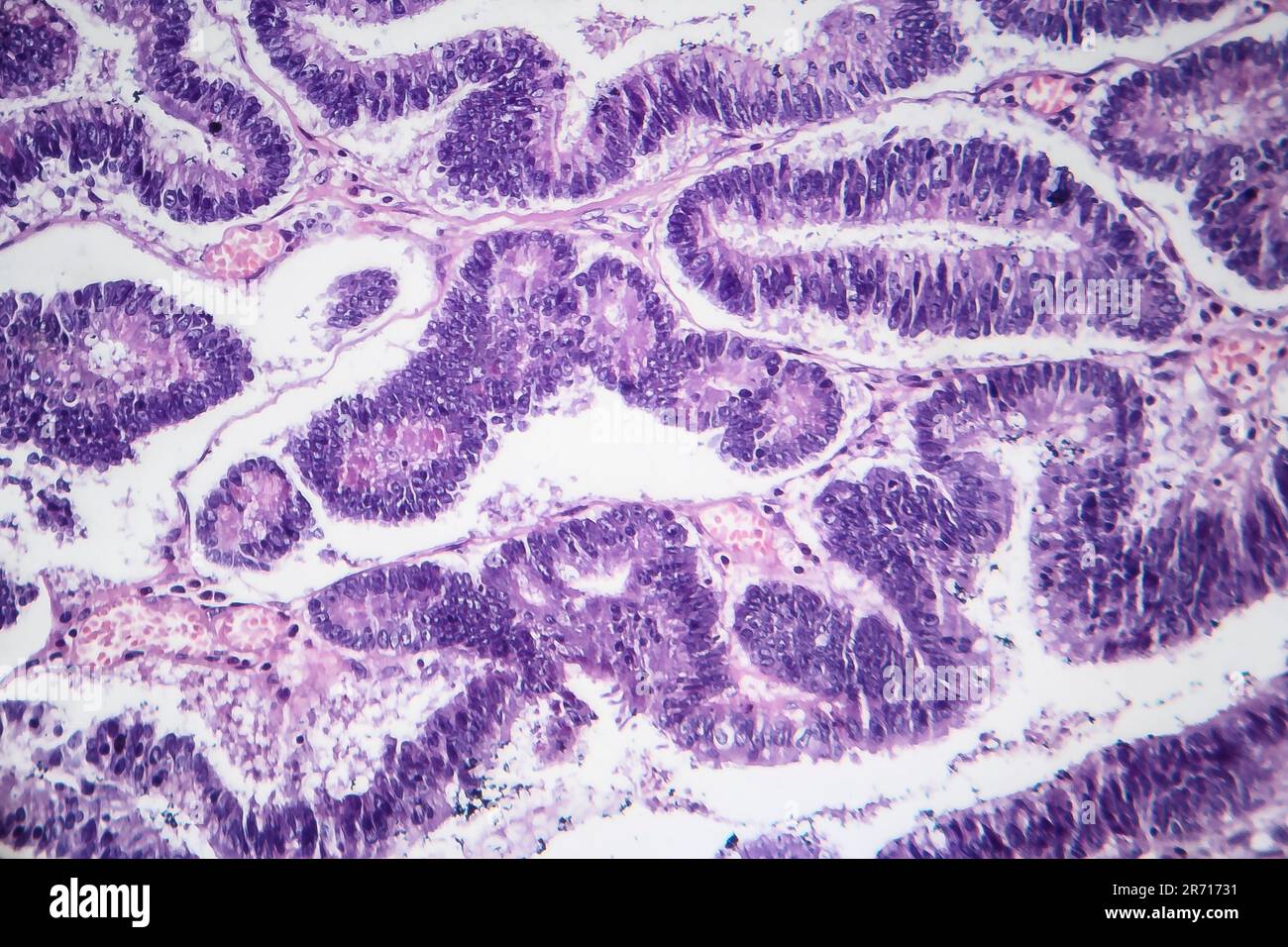 Histopathologie de l'adénome intestinal, micrographe léger, photo sous ...