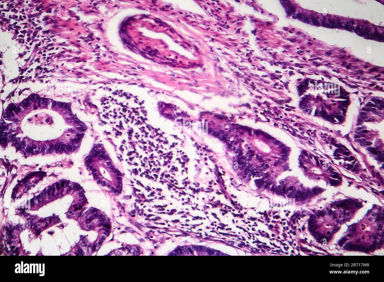 Cancer du côlon, micrographe léger, photo sous microscope Photo Stock ...