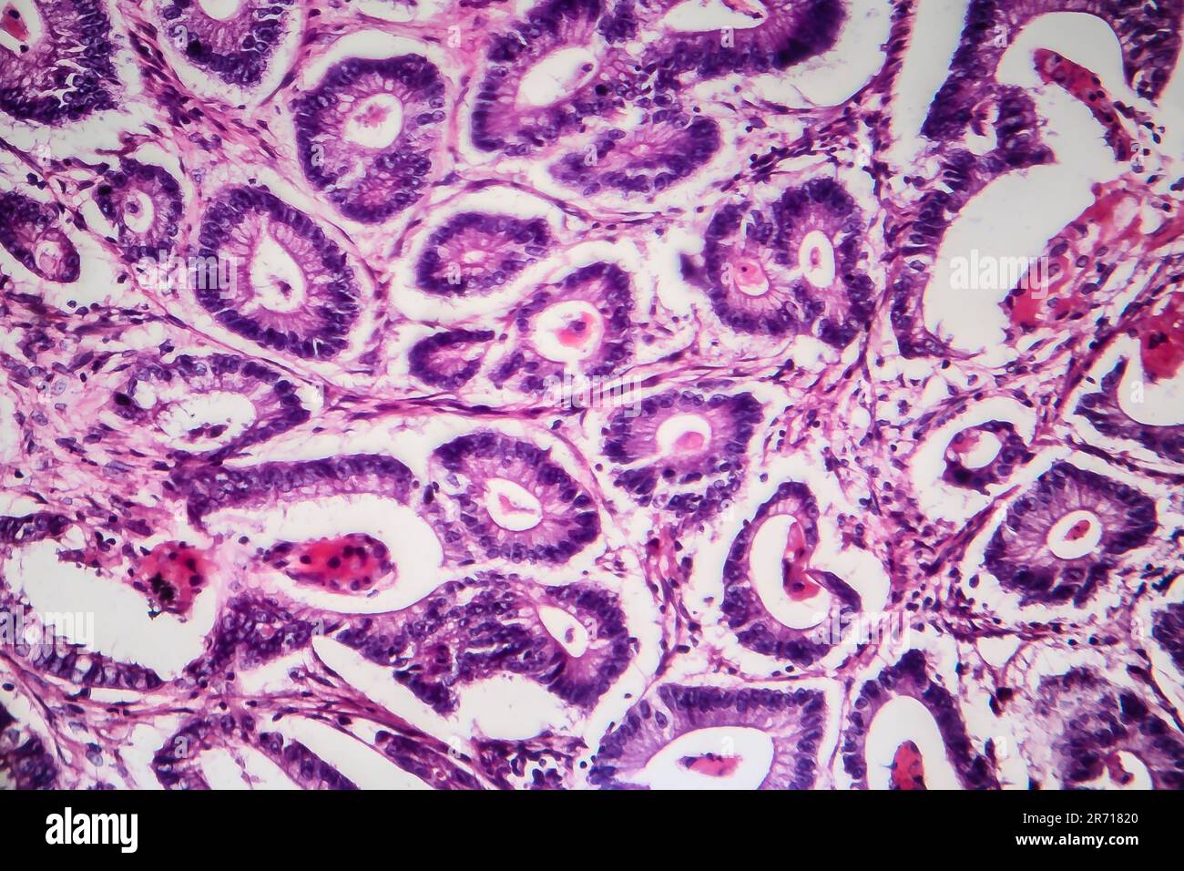 Cancer du côlon, micrographe léger, photo sous microscope Photo Stock ...