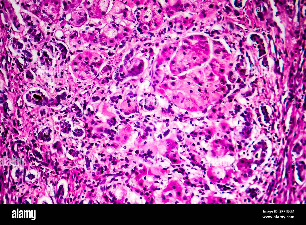 Histopathologie de la cirrhose biliaire du foie, micrographe léger ...