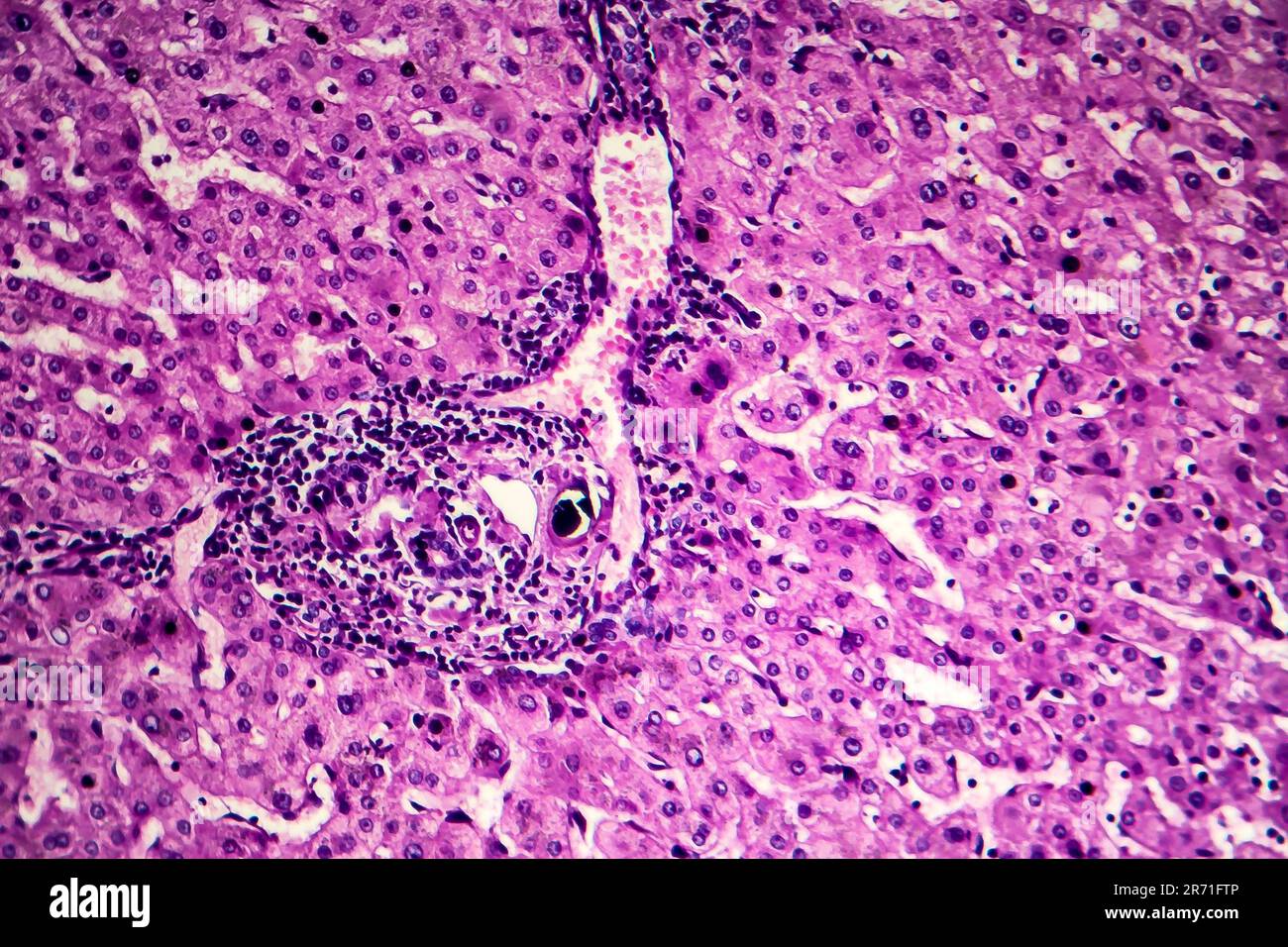 Schistosomiase hépatique, micrographe léger, photo sous microscope ...