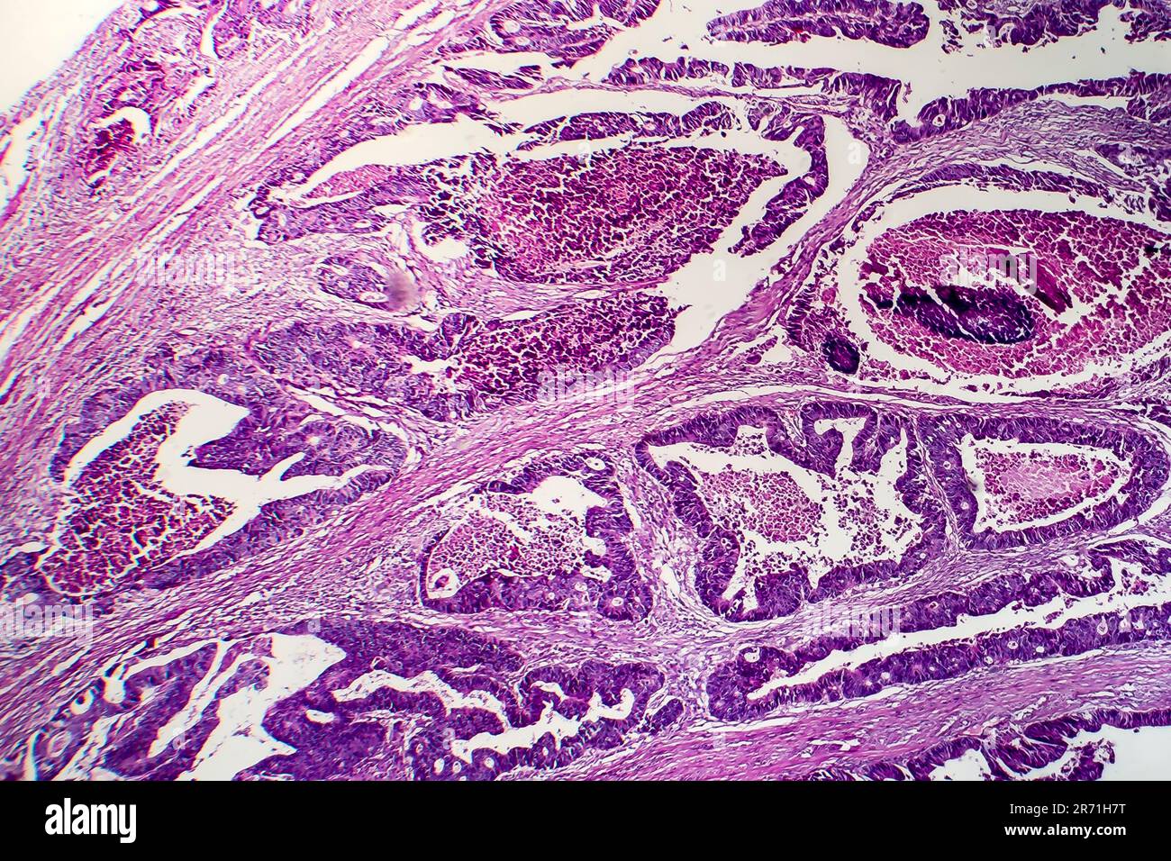 Adénocarcinome intestinal différencié, micrographe léger, photo sous ...