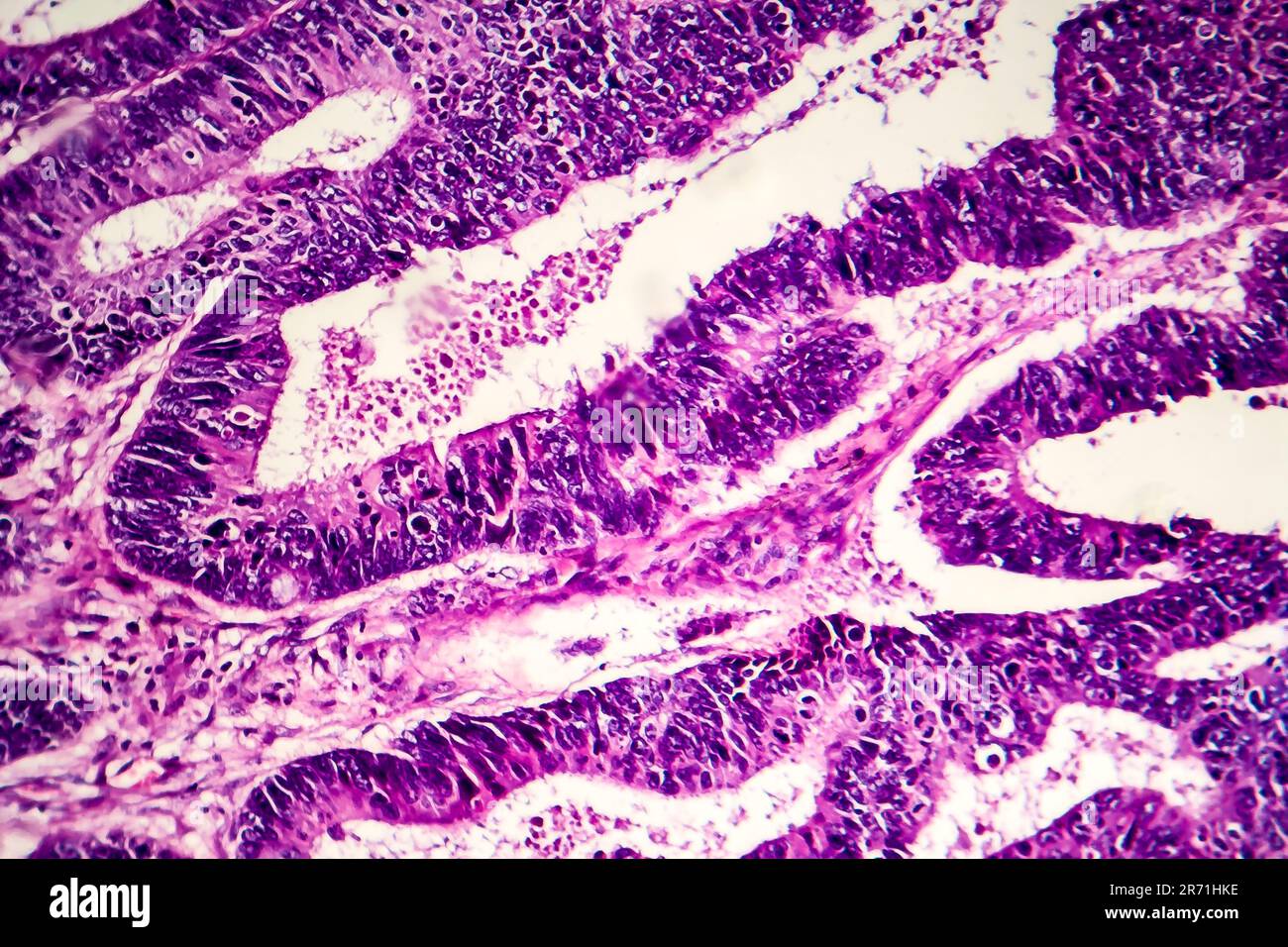 Adénocarcinome intestinal différencié, micrographe léger, photo sous ...