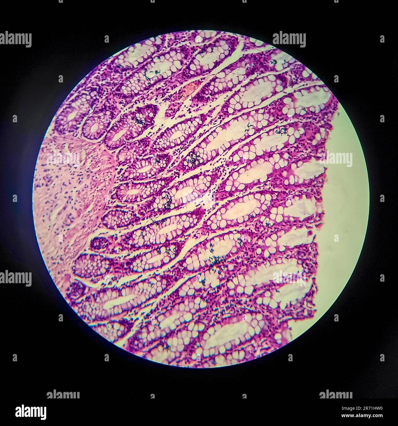 Dysenterie bacillaire, micrographe léger, photo sous microscope ...