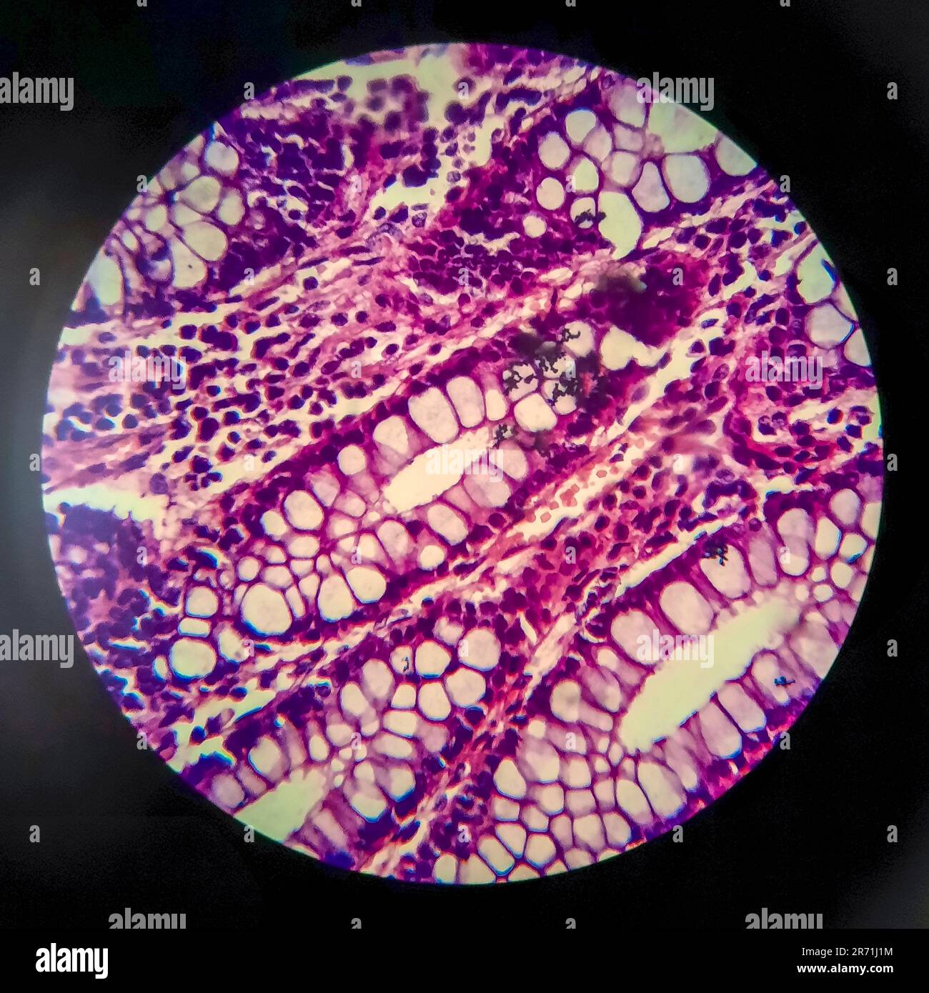 Dysenterie bacillaire, micrographe léger, photo sous microscope ...