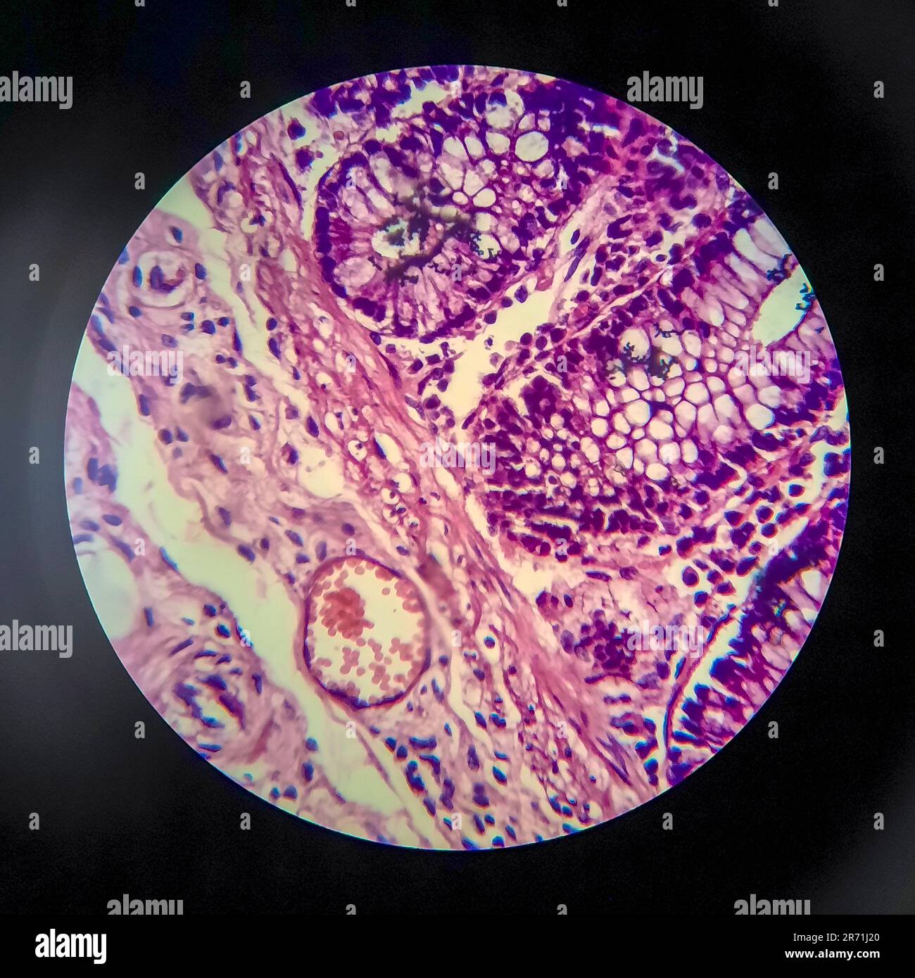 Dysenterie bacillaire, micrographe léger, photo sous microscope ...