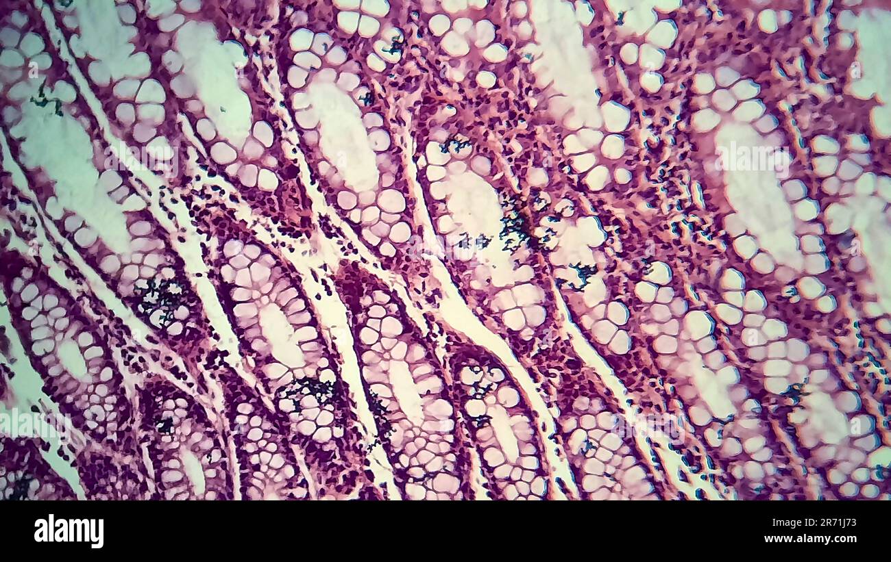Dysenterie bacillaire, micrographe léger, photo sous microscope ...