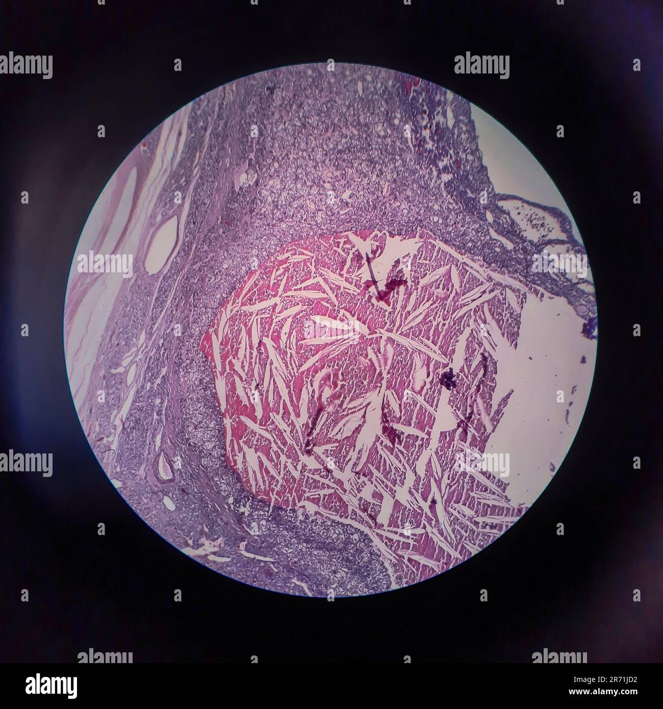 Carcinome folliculaire thyroïdien, micrographe léger, photo sous ...
