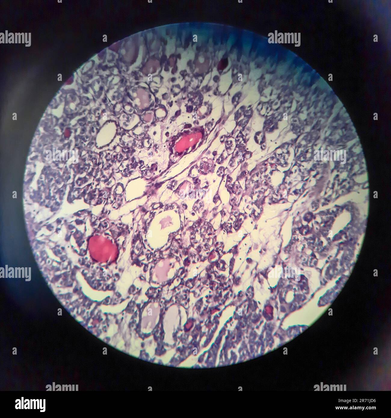 Carcinome folliculaire thyroïdien, micrographe léger, photo sous ...
