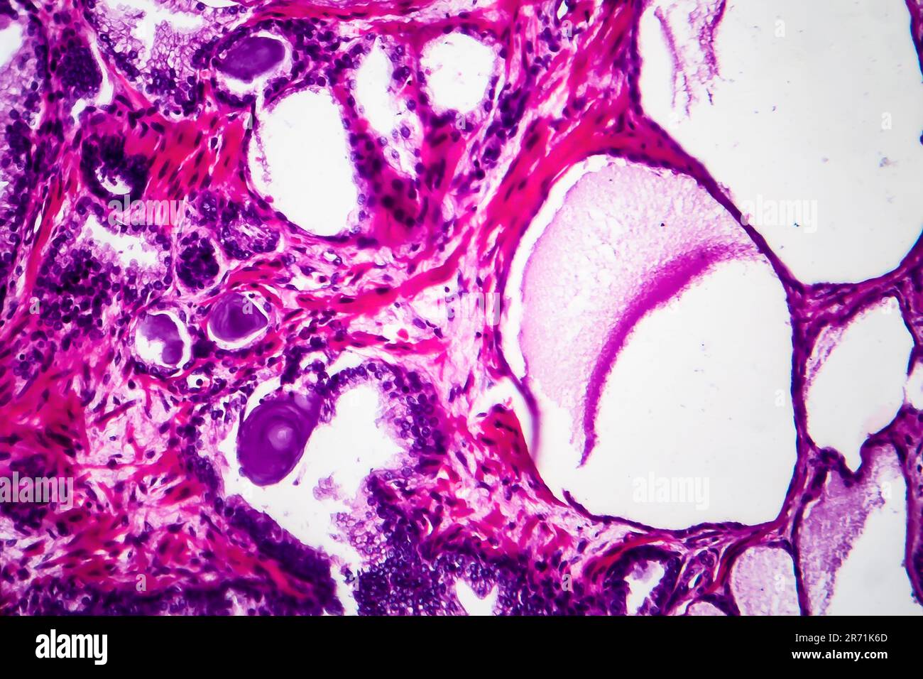 Hyperplasie bénigne de la prostate, micrographe léger, photo sous ...