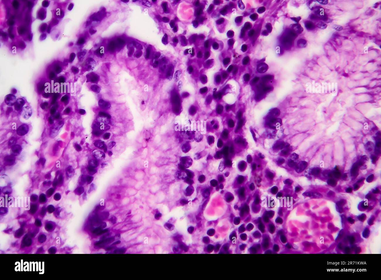 Histopathologie de l'adénocarcinome de l'estomac, micrographe léger ...