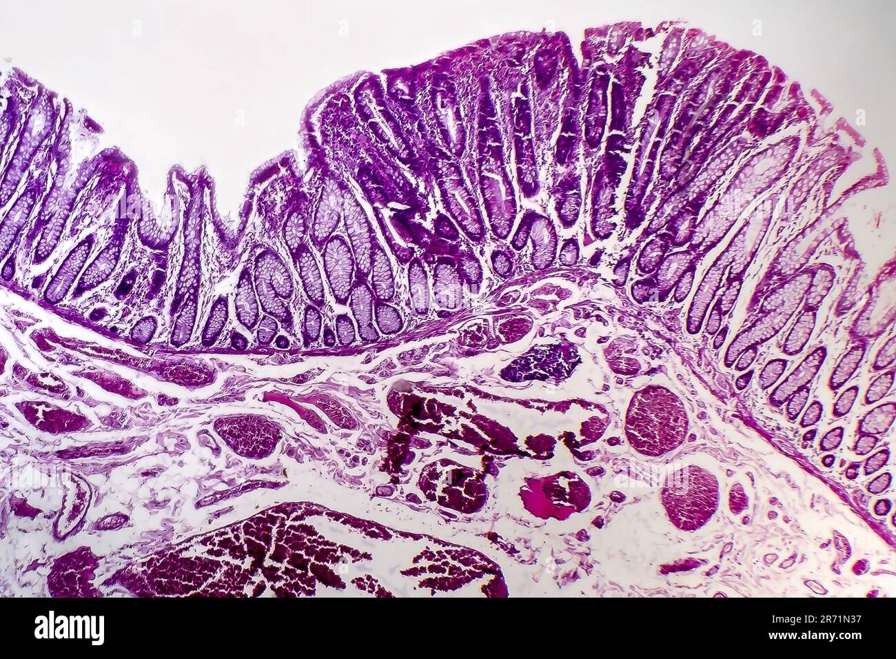 Adénocarcinome du côlon villeux, micrographe léger, photo sous ...