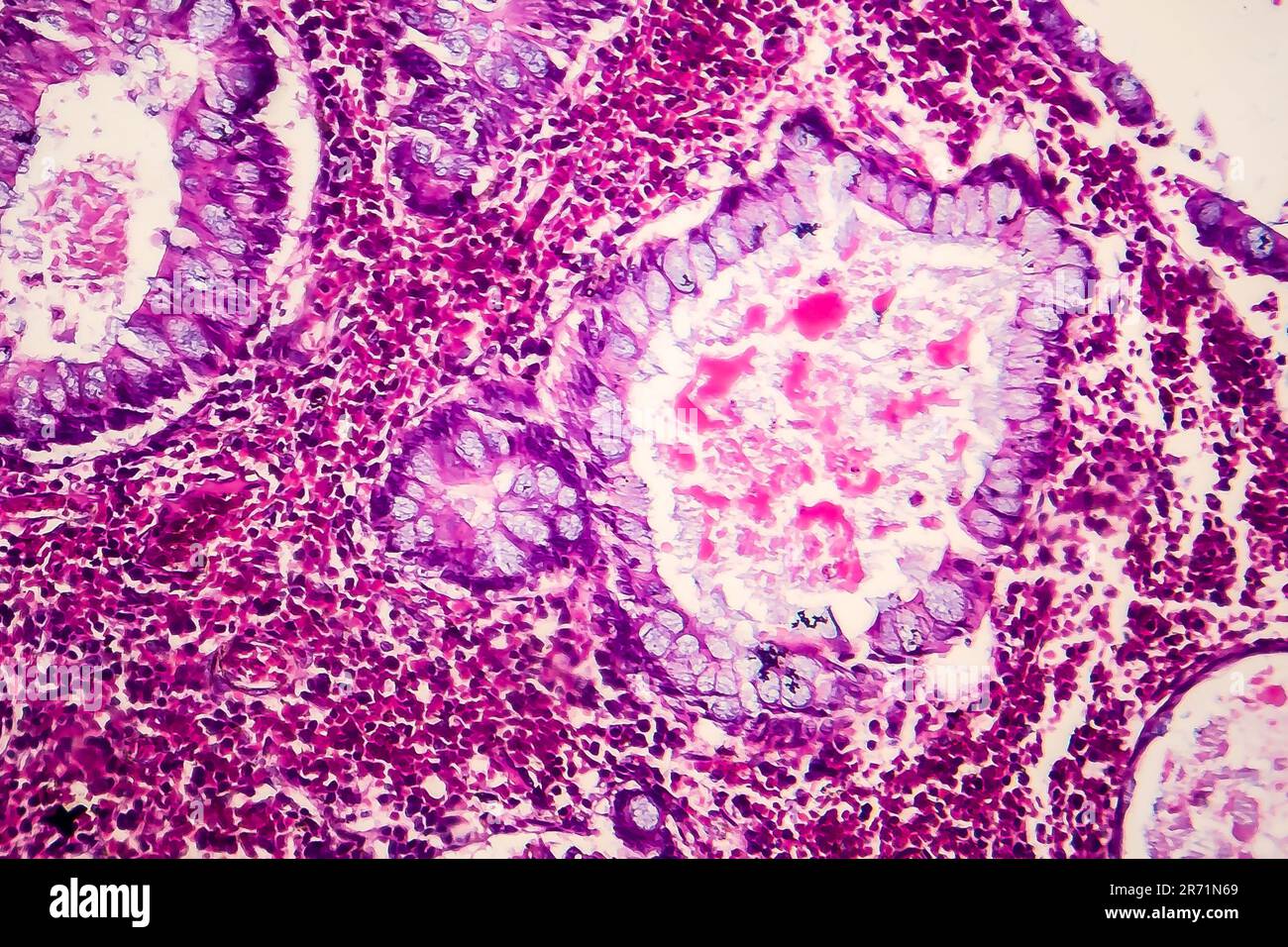 Adénocarcinome du côlon villeux, micrographe léger, photo sous ...