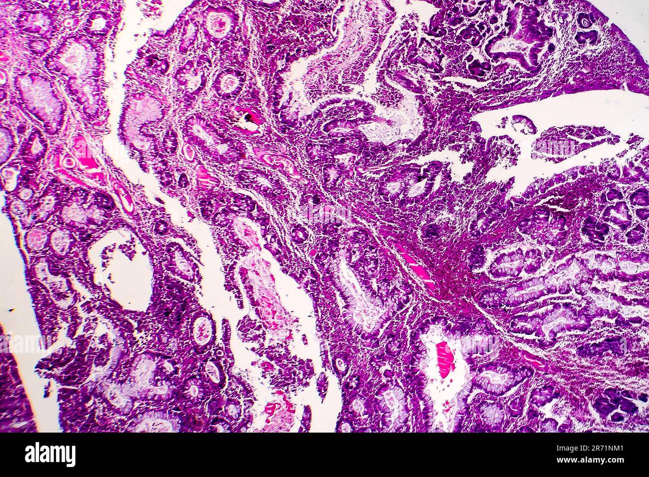 Adénocarcinome du côlon villeux, micrographe léger, photo sous ...