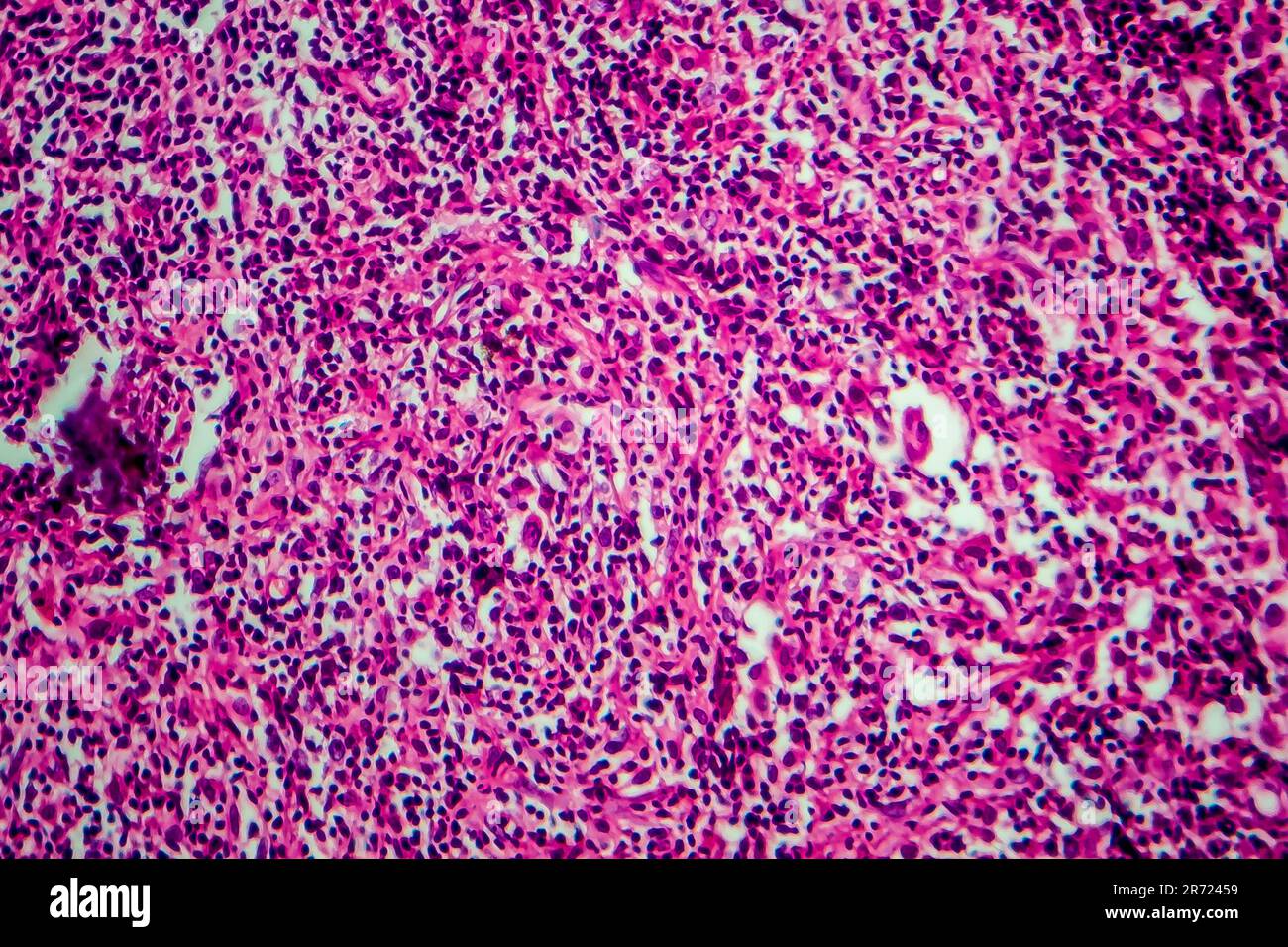 Lymphome de Hodgkin, micrographe léger, photo sous microscope Photo ...
