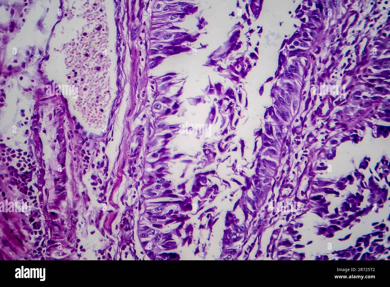 Carcinome cellulaire transitoire de la vessie, micrographe léger, photo ...